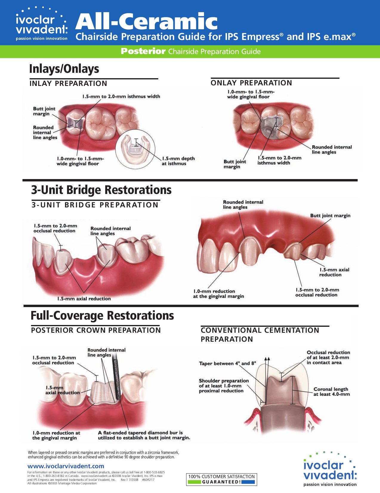 emax chairside prep guide by Ivoclar Vivadent - Issuu