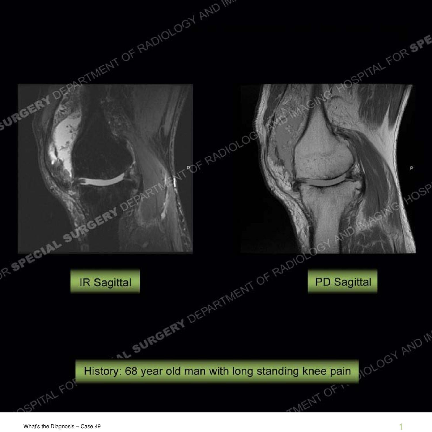 Hospital For Special Surgery: What's the Diagnosis - Case 49 by ...