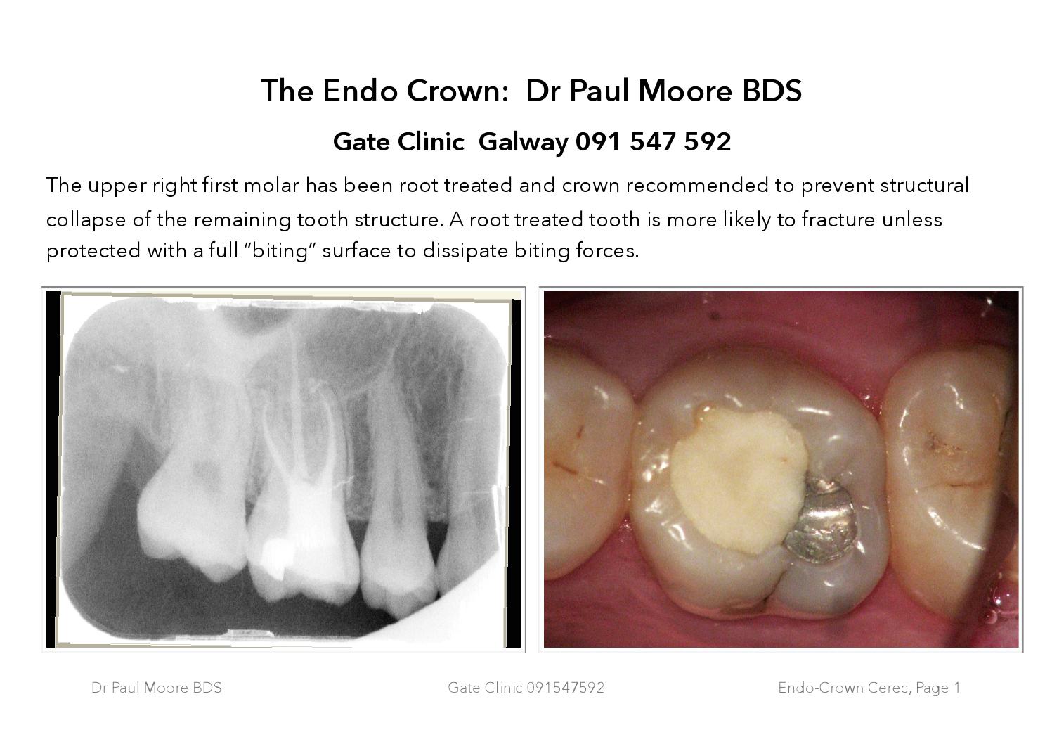 The endo crown, one visit retoration of a root treated molar by Dr Paul ...