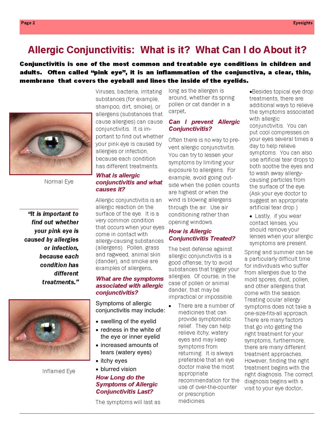 Allergic Conjunctivitis Treatment