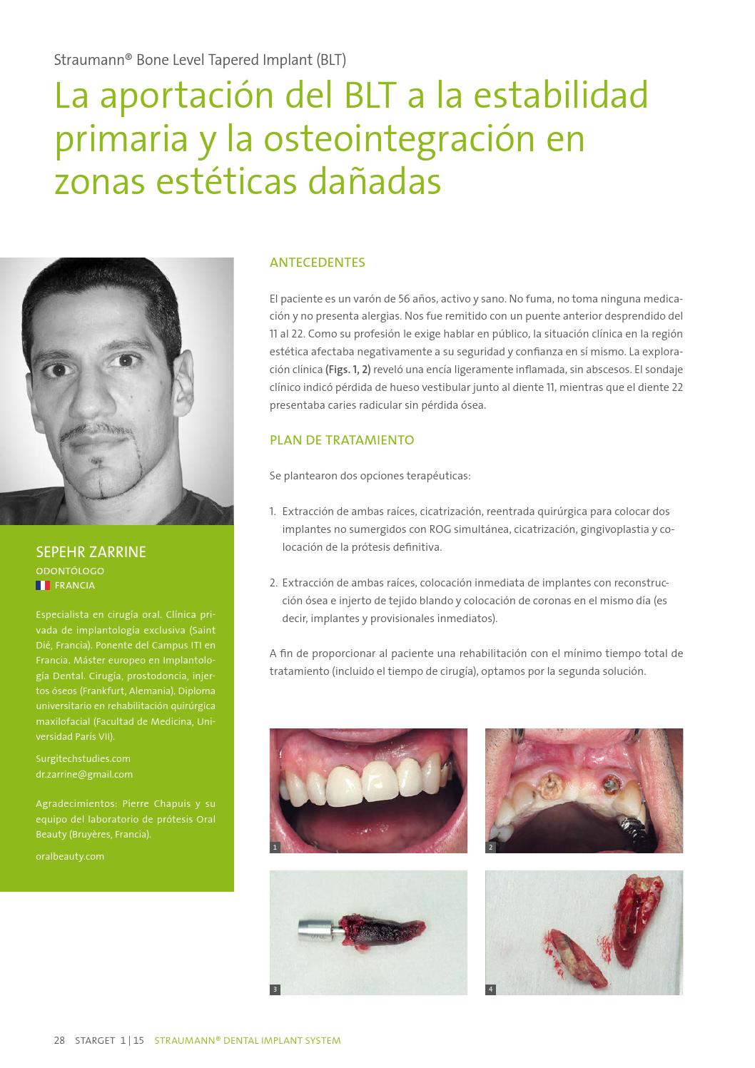 Straumann® Bone Level Tapered Implant (BLT) by Institut Straumann AG ...