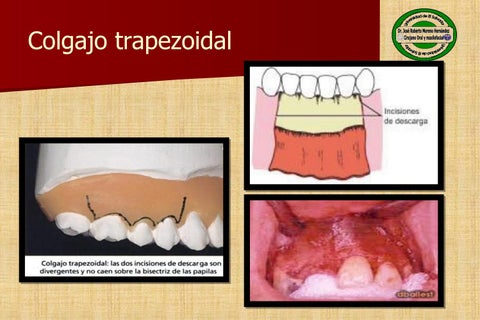 Preparación del colgajo by jmor_her99 - Issuu