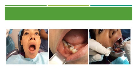 Exodoncia quirúrgica by jmor_her99 - Issuu