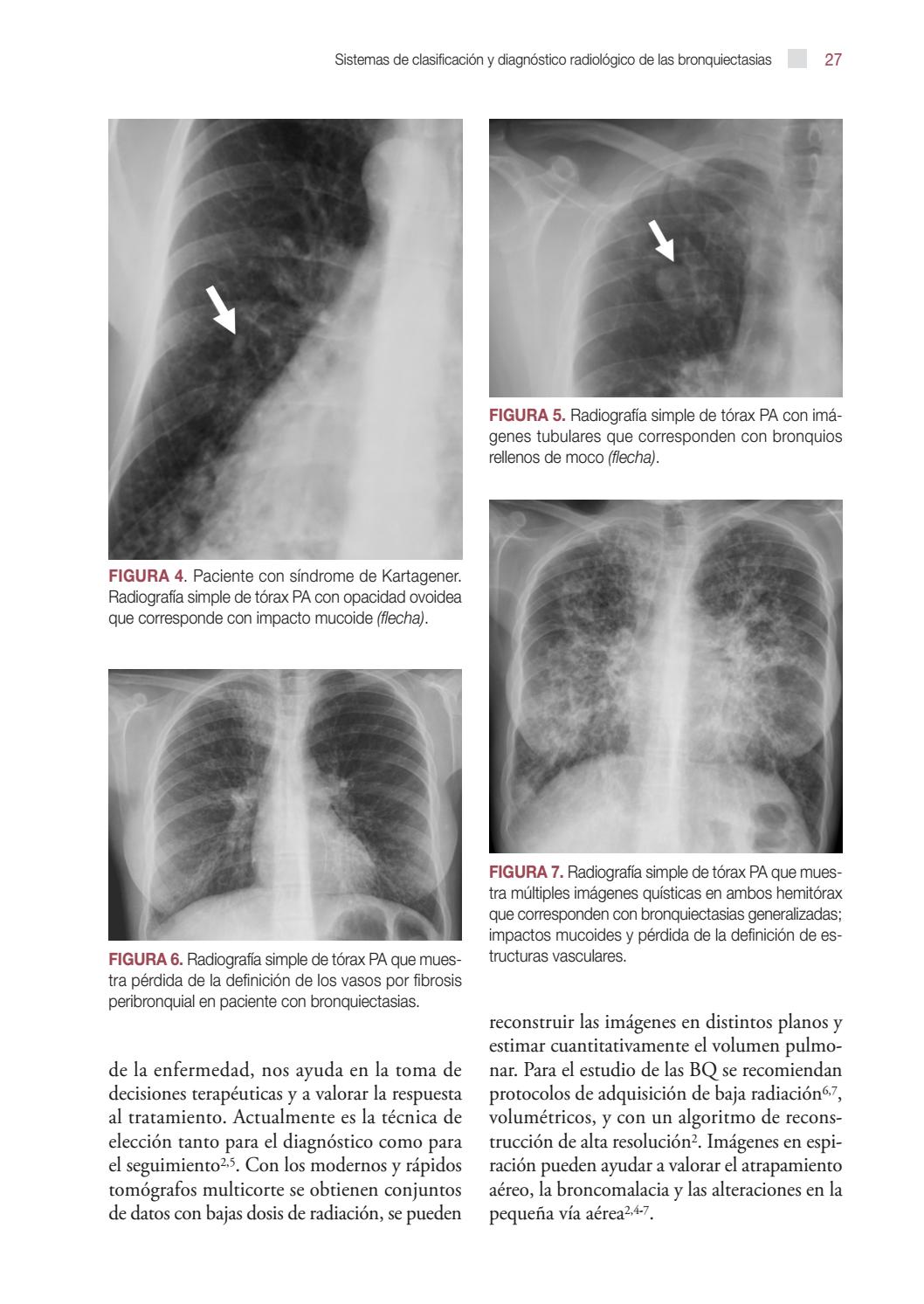 Monografía 2 bronquiectasias by SEPAR - Issuu