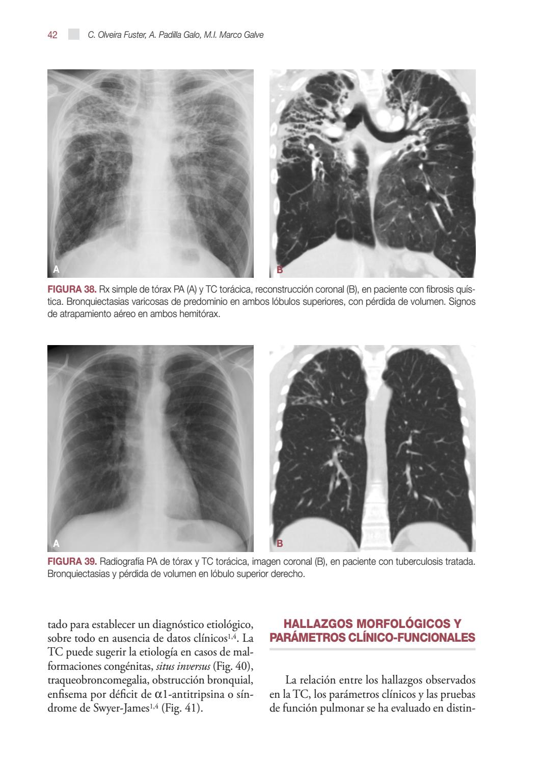 Monografía 2 bronquiectasias by SEPAR - Issuu