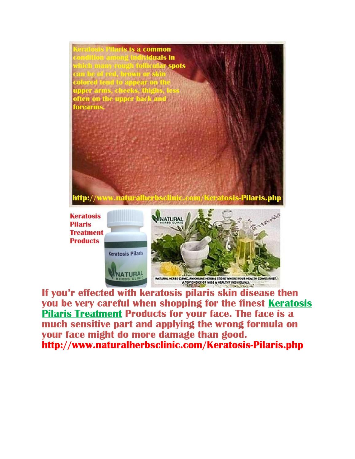 Keratosis Pilaris Treatment Products By Natural Herbs Clinic Issuu