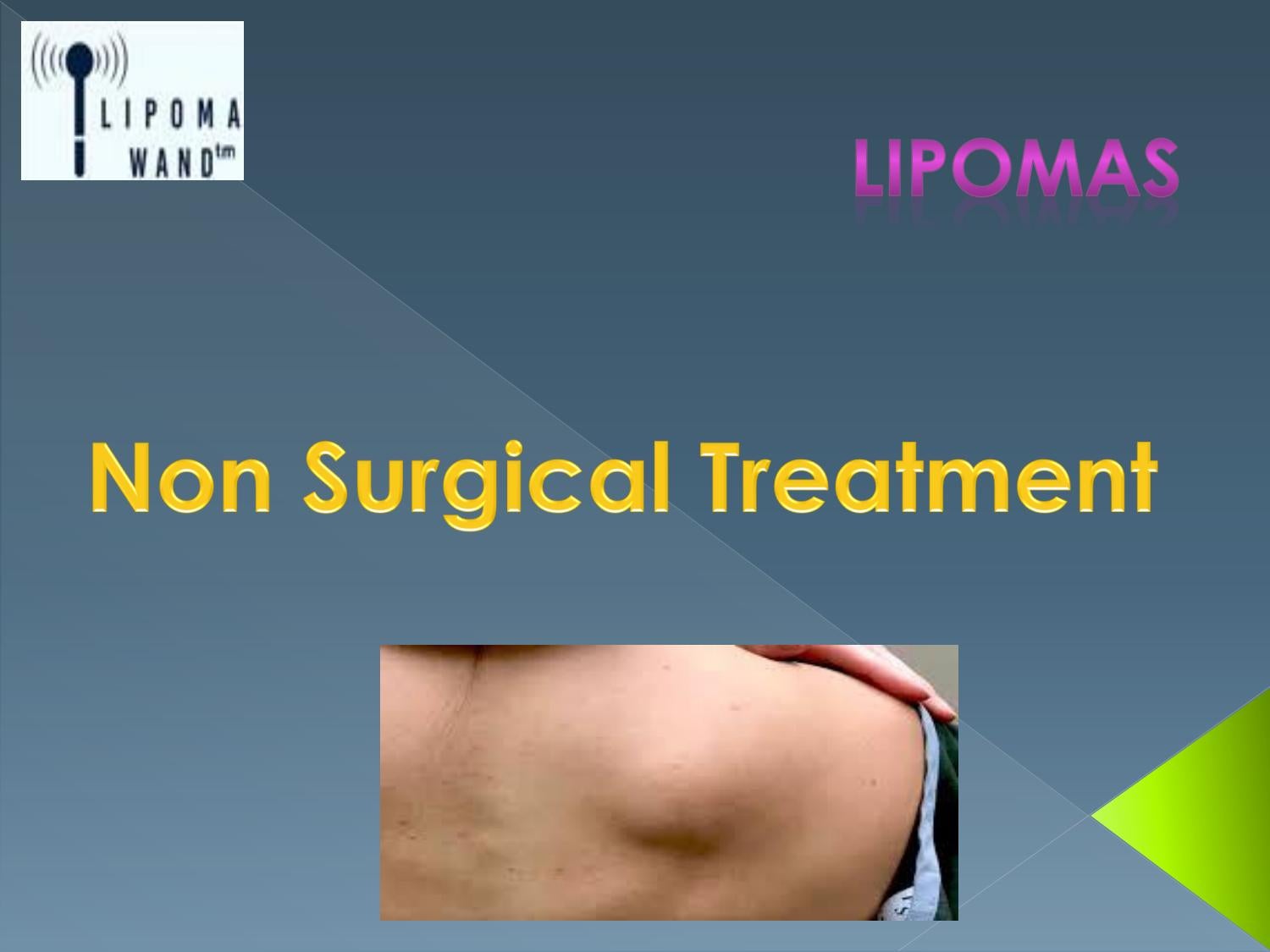 Get a Natural Treatment for Lipoma by Lipoma Wand - Issuu