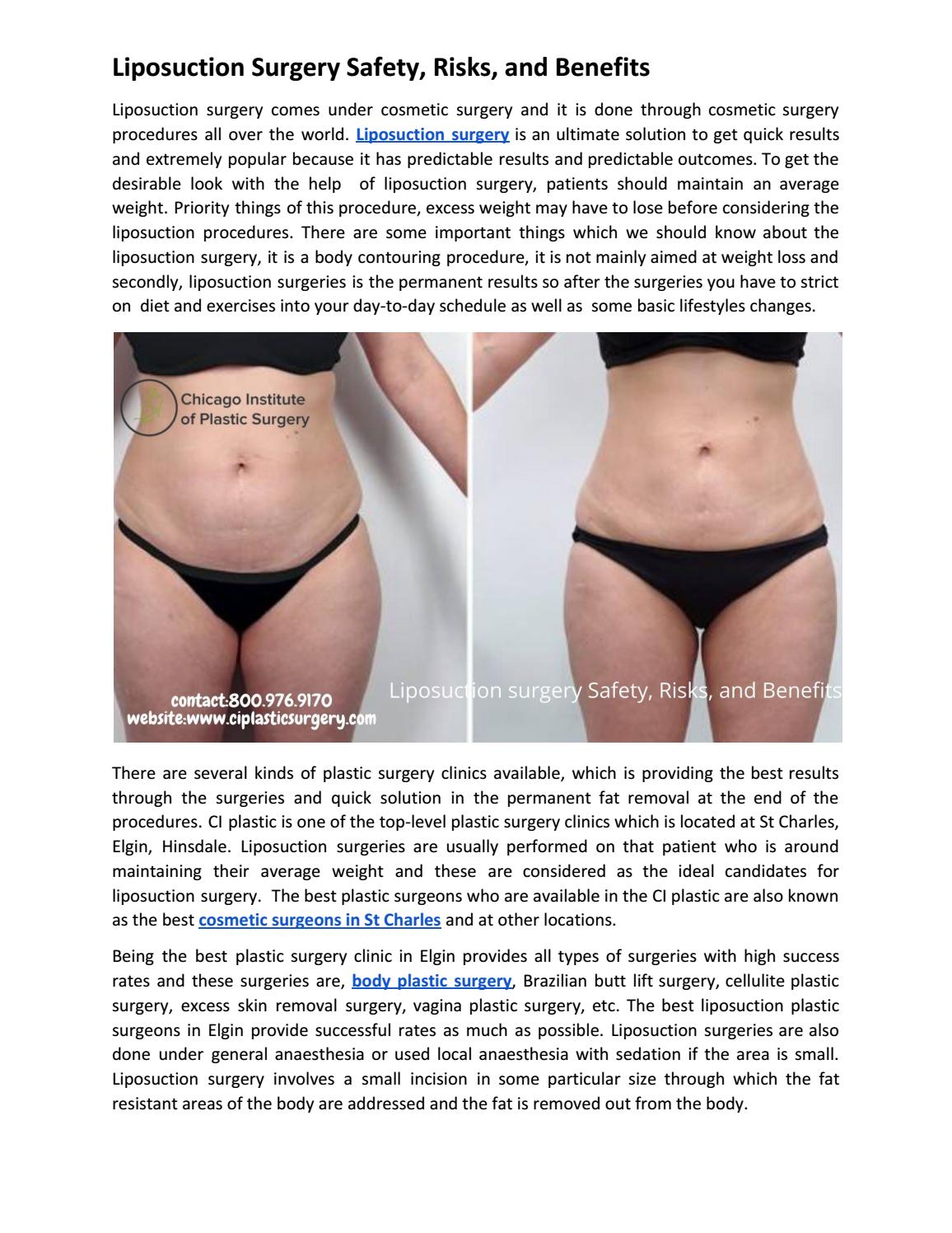 Liposuction Surgery Safety, Risks, and Benefits by CIPLASTIC SURGERY - Issuu