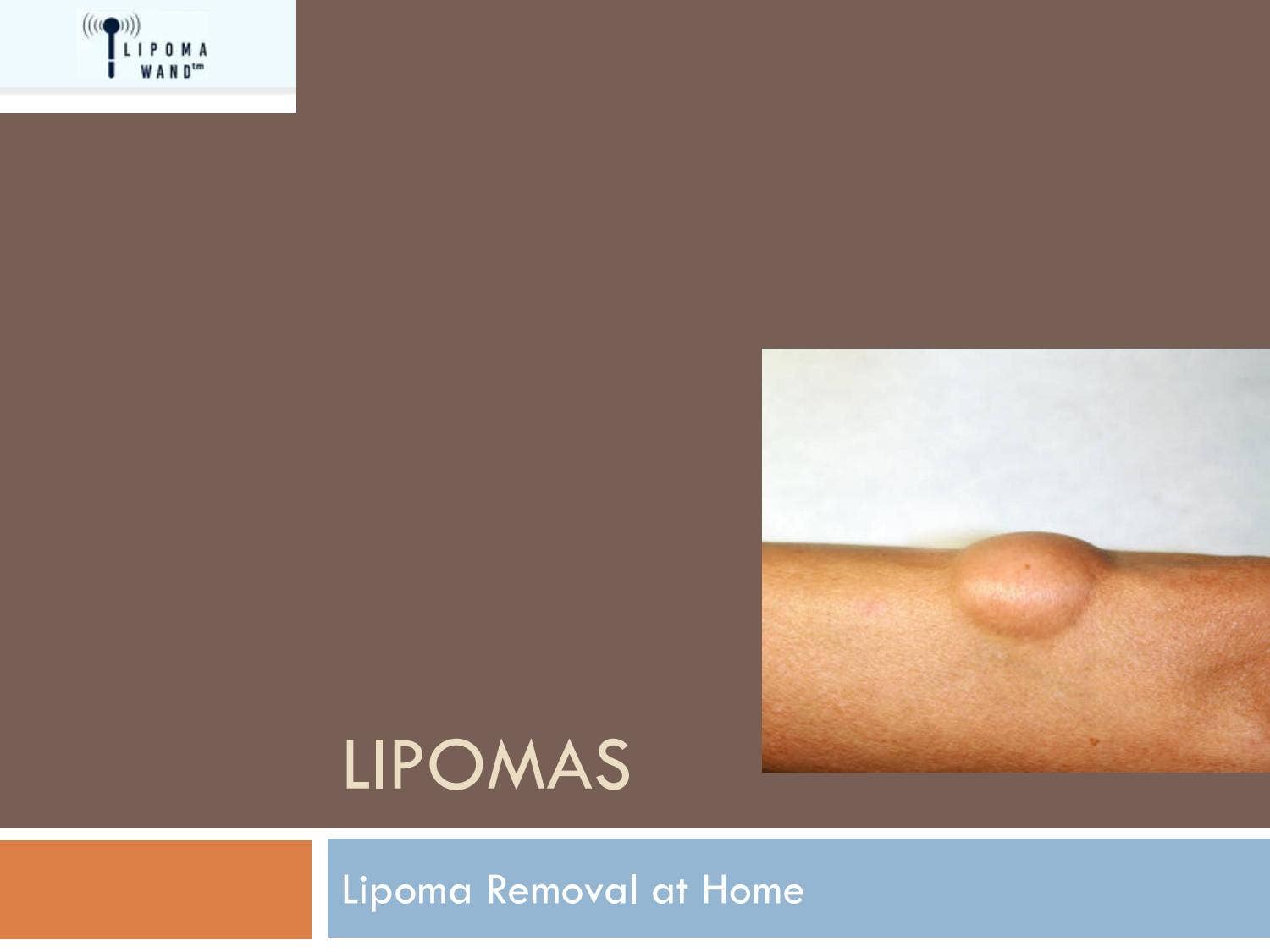 Get a Natural Lipoma Treatment at Home by Lipoma Wand - Issuu
