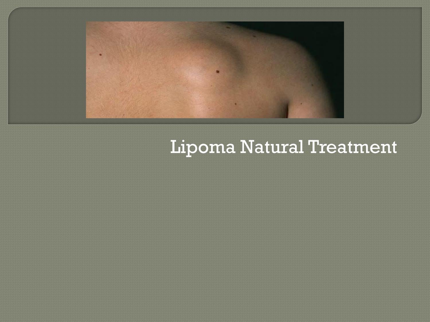 Best Lipoma Natural Treatment by Lipoma Wand - Issuu