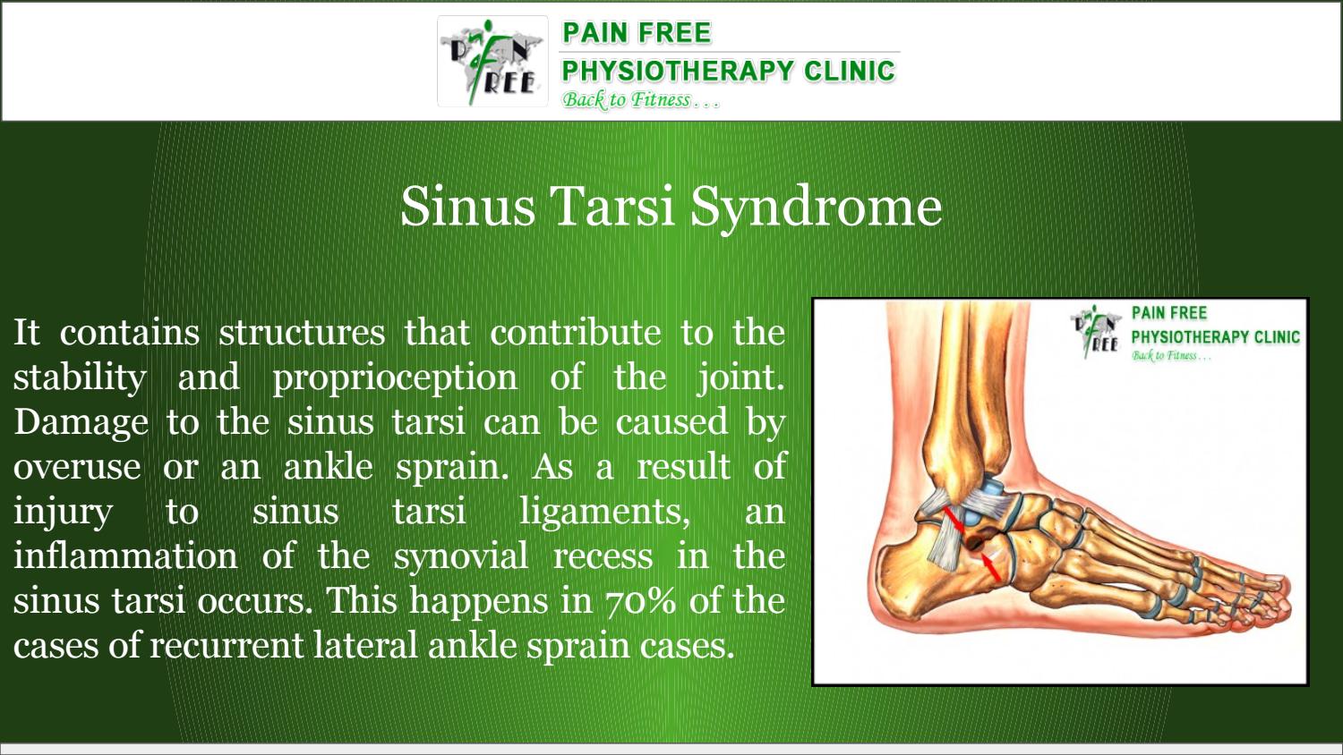 Sinus Tarsi Syndrome | Pain Free Physiotherapy by Pain Free ...