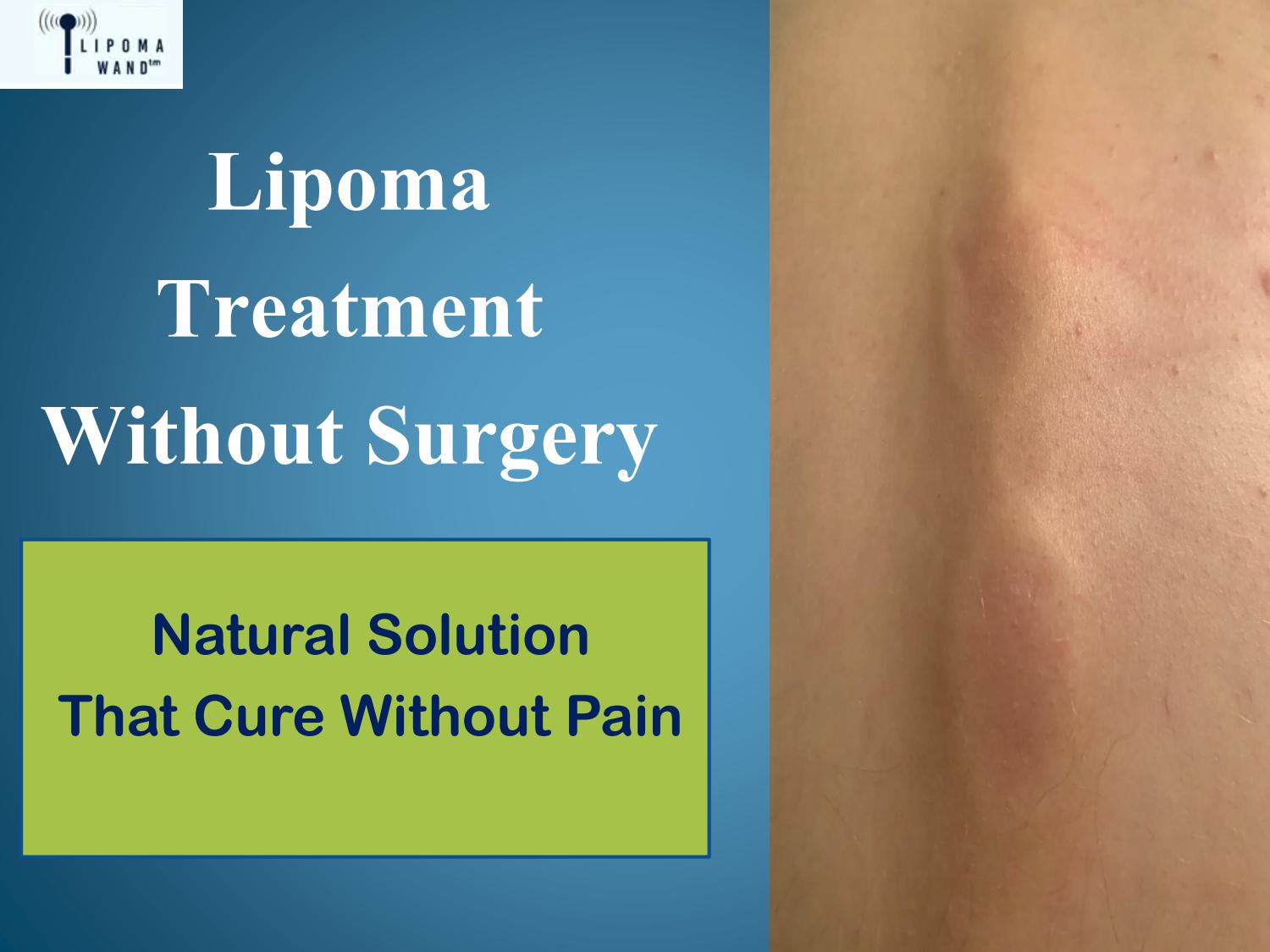 Discover a New Solution for Lipoma Treatment at Home by Lipoma Wand - Issuu