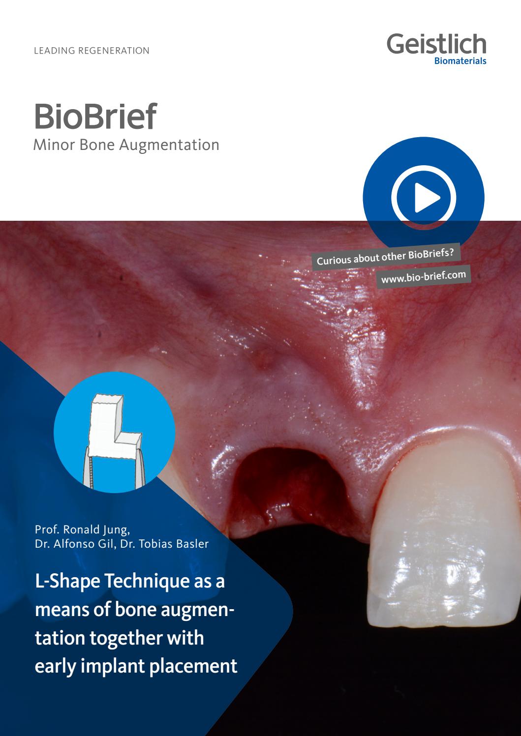 L-Shape Technique as a means of bone augmentation together with early implant placement by ...