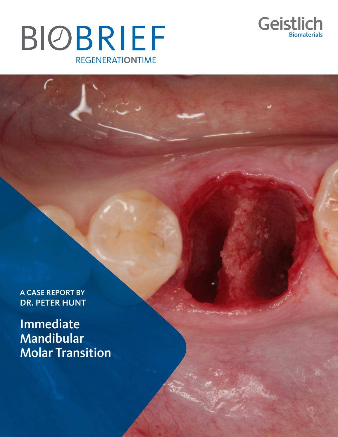 A Case Report by Dr. Peter Hunt - Immediate Mandibular Molar Transition ...