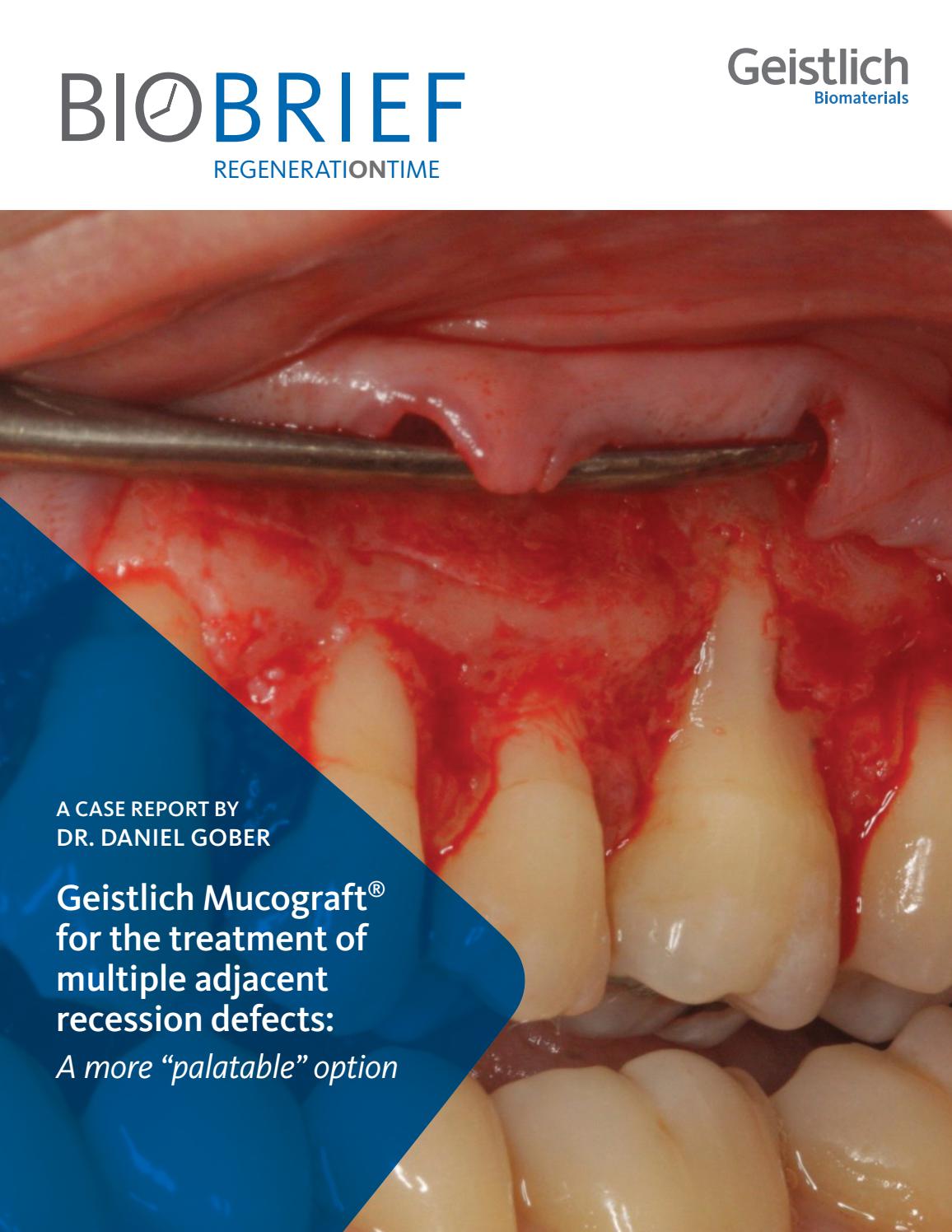 Geistlich Mucograft® for the treatment of multiple adjacent recession ...