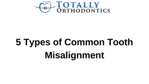 5 Types of Common Tooth Misalignment by Totally Orthodontics - Issuu