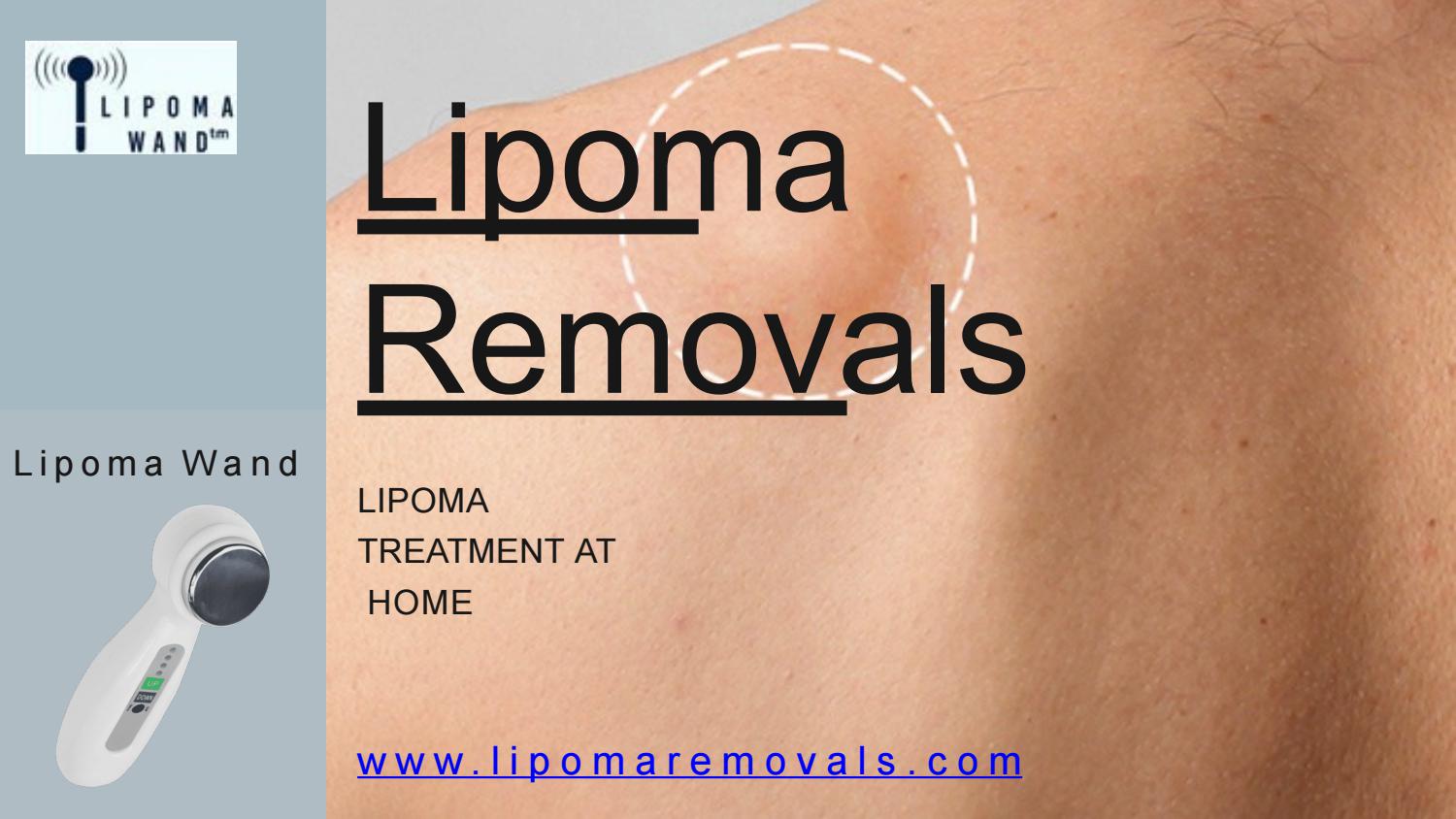 Lipoma Removals Without Surgery With a Simple Portable Wand. by rosa ...