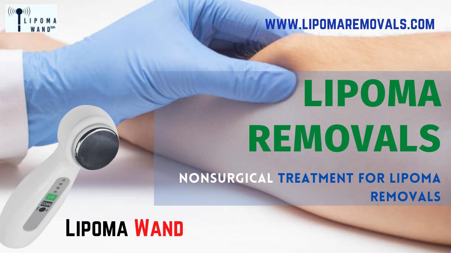 Get Effective Lipoma Treatment at Home by rosa patrick - Issuu