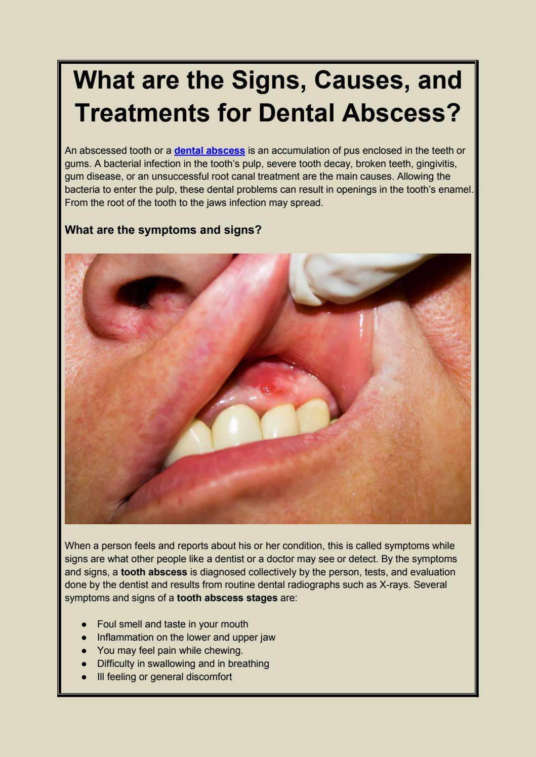 What are the Signs, Causes, and Treatments for Dental Abscess? by ...