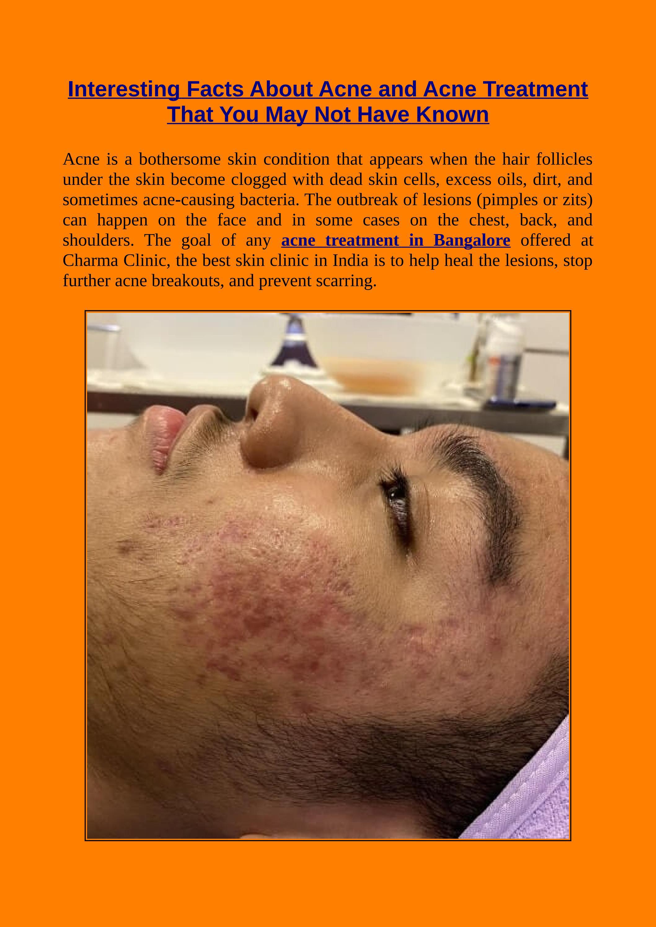 Interesting Facts About Acne Treatment That You May Not Have Known by ...