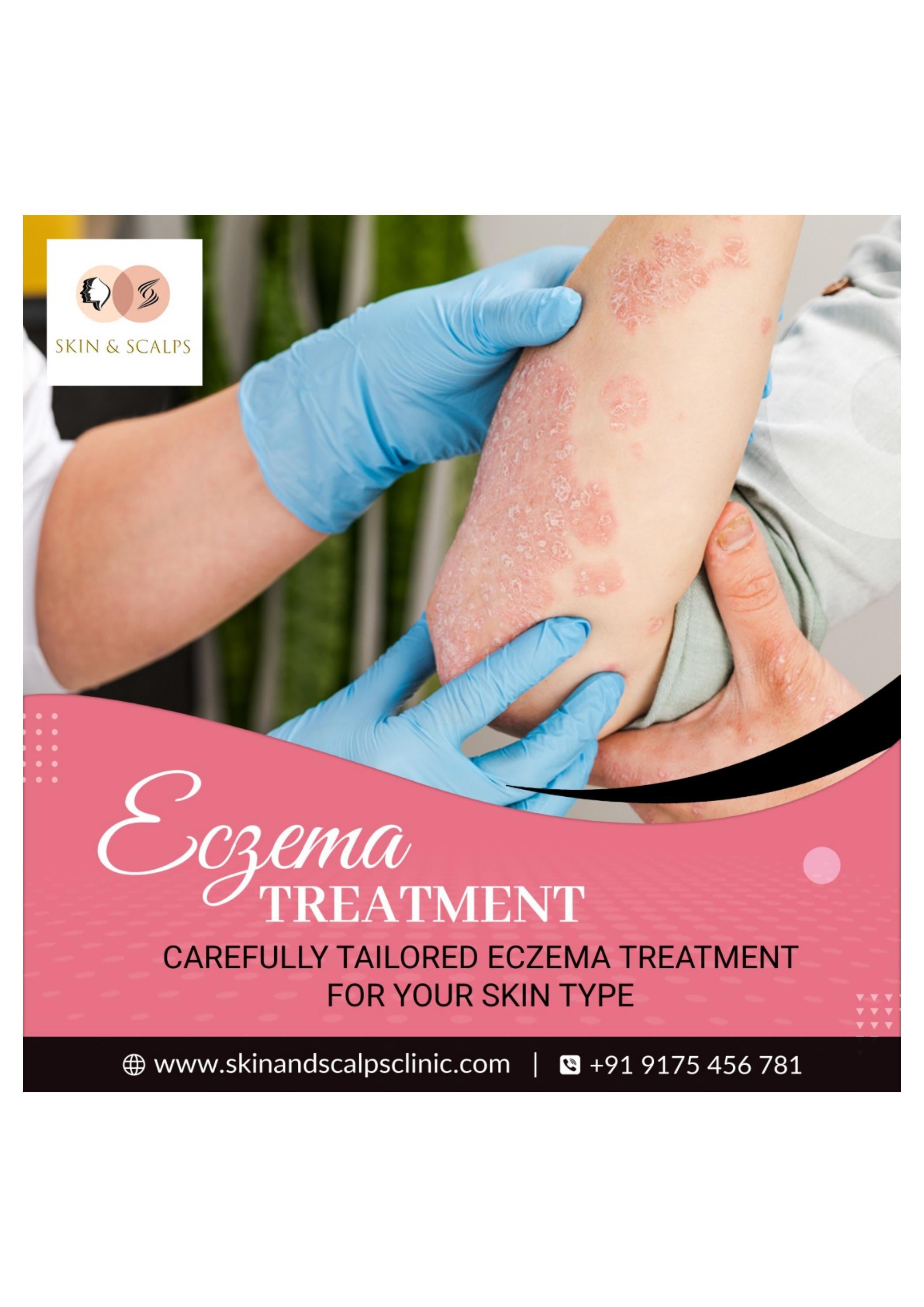 Carefully tailored eczema treatment for your skin type by Skin and ...