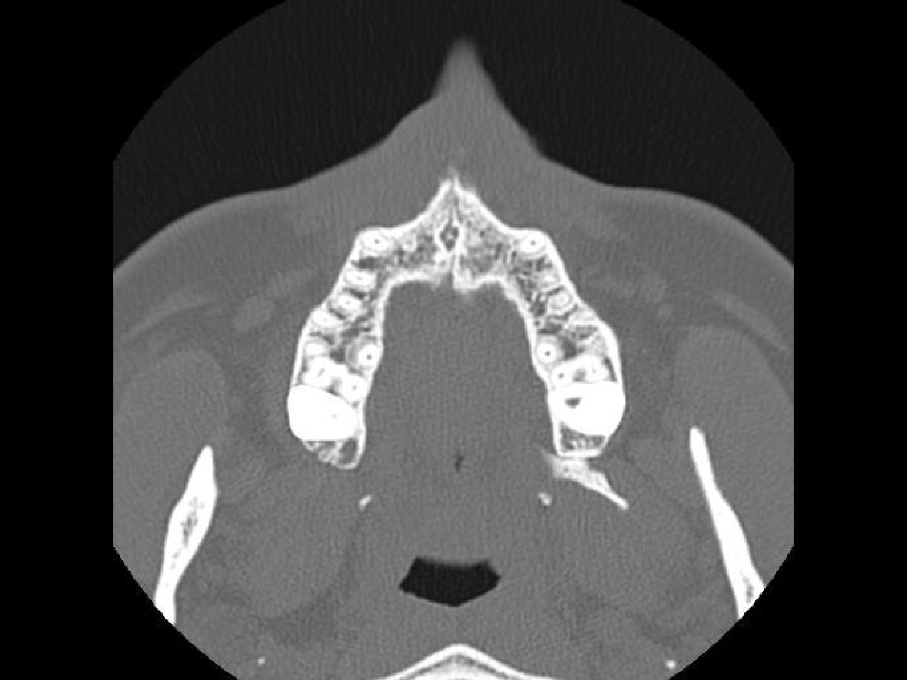 Head & Neck Rotation: Sinus Anatomy by uwiscradiology - Issuu
