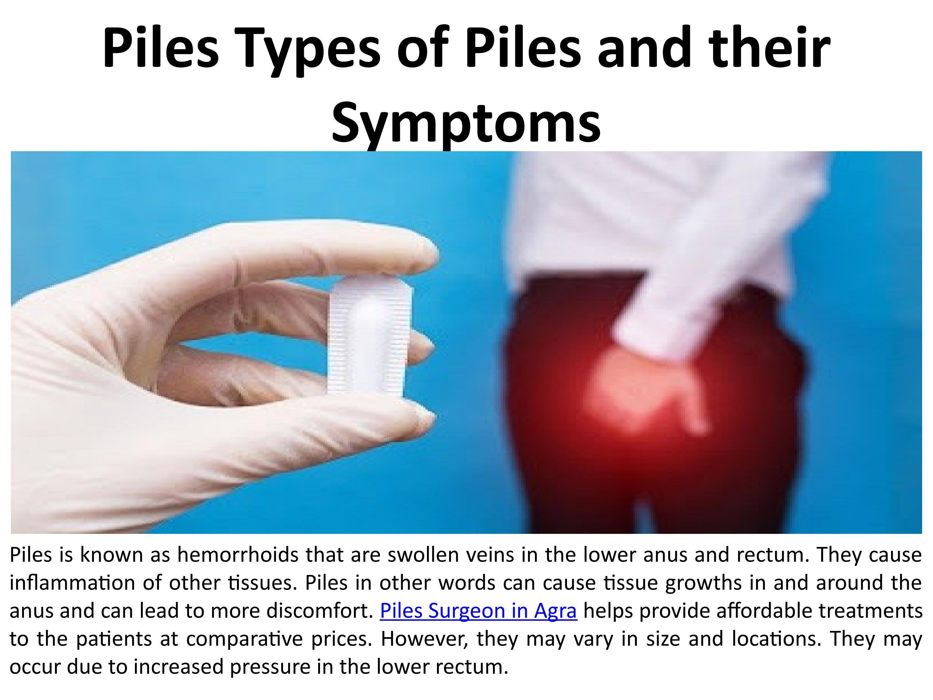Symptoms Of Pile And Their Types By Safe Surgery Center Issuu