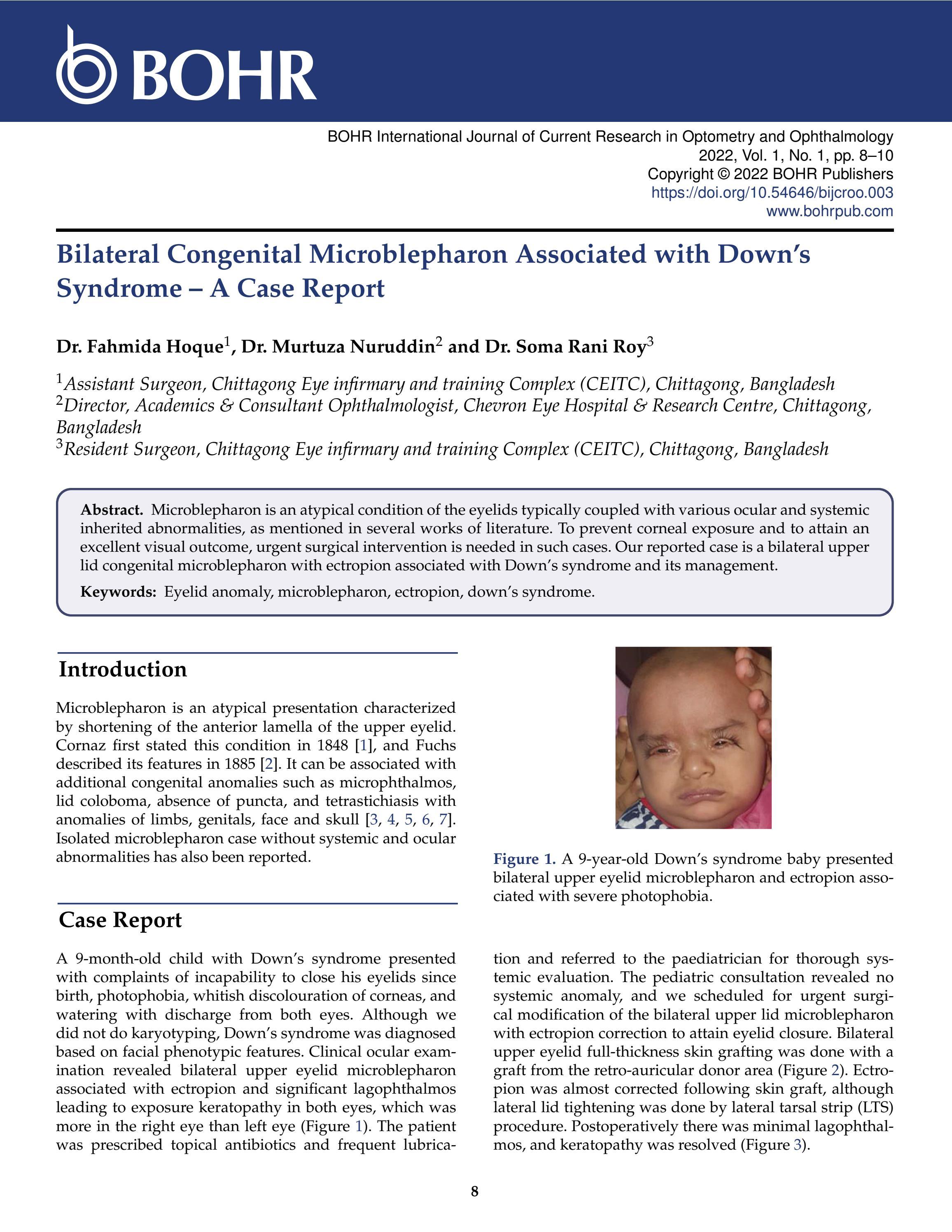 Bilateral Congenital Microblepharon Associated with Down’s Syndrome – A ...
