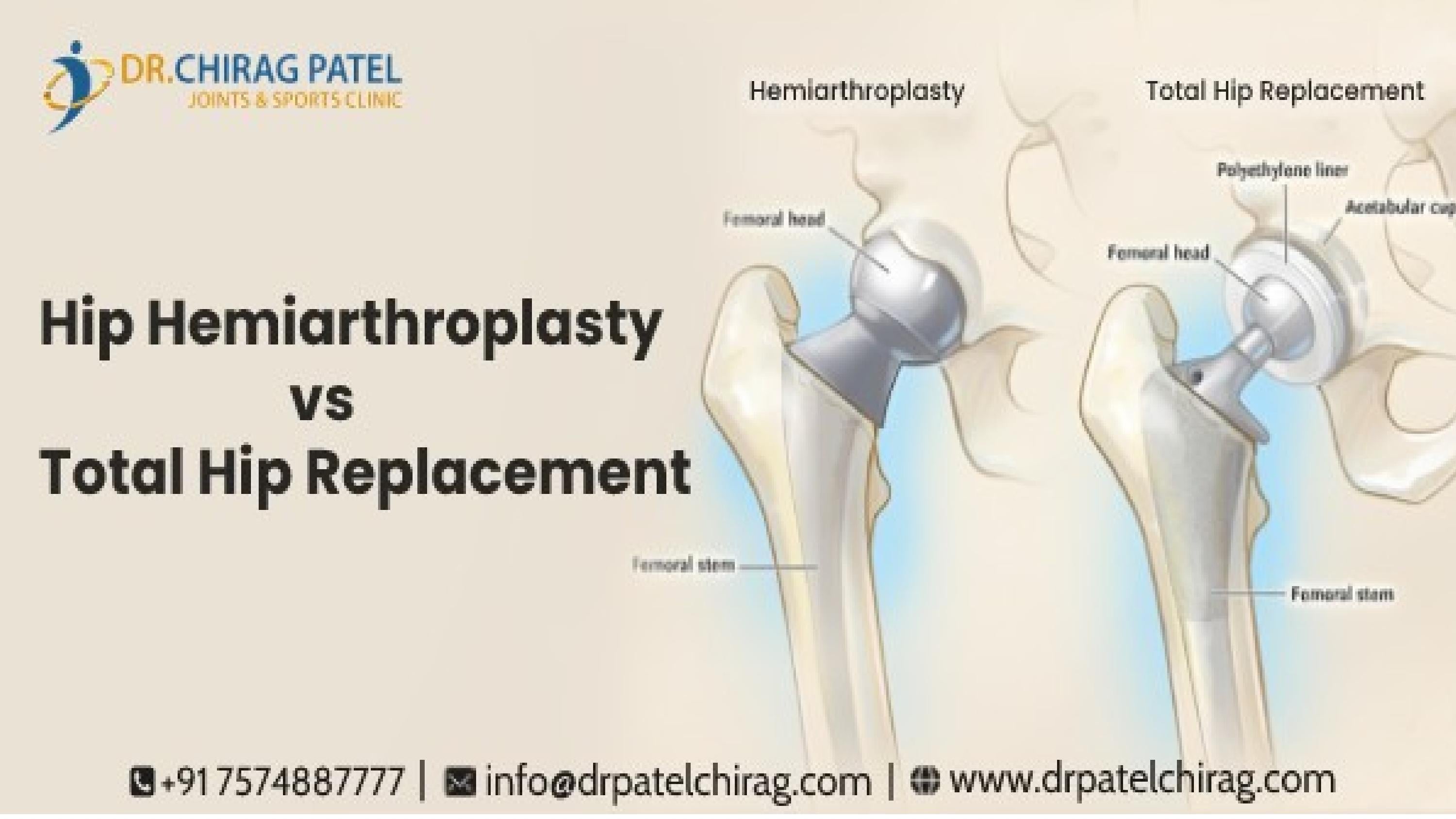 Hip Hemiarthroplasty vs Total Hip Replacement Indications by ...