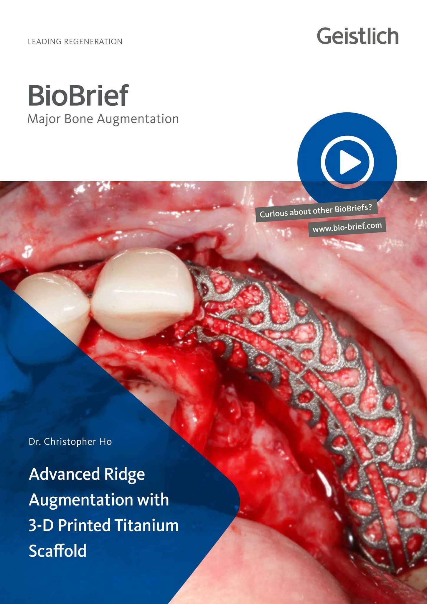 Advanced Ridge Augmentation with 3-D Printed Titanium Scaffold by ...
