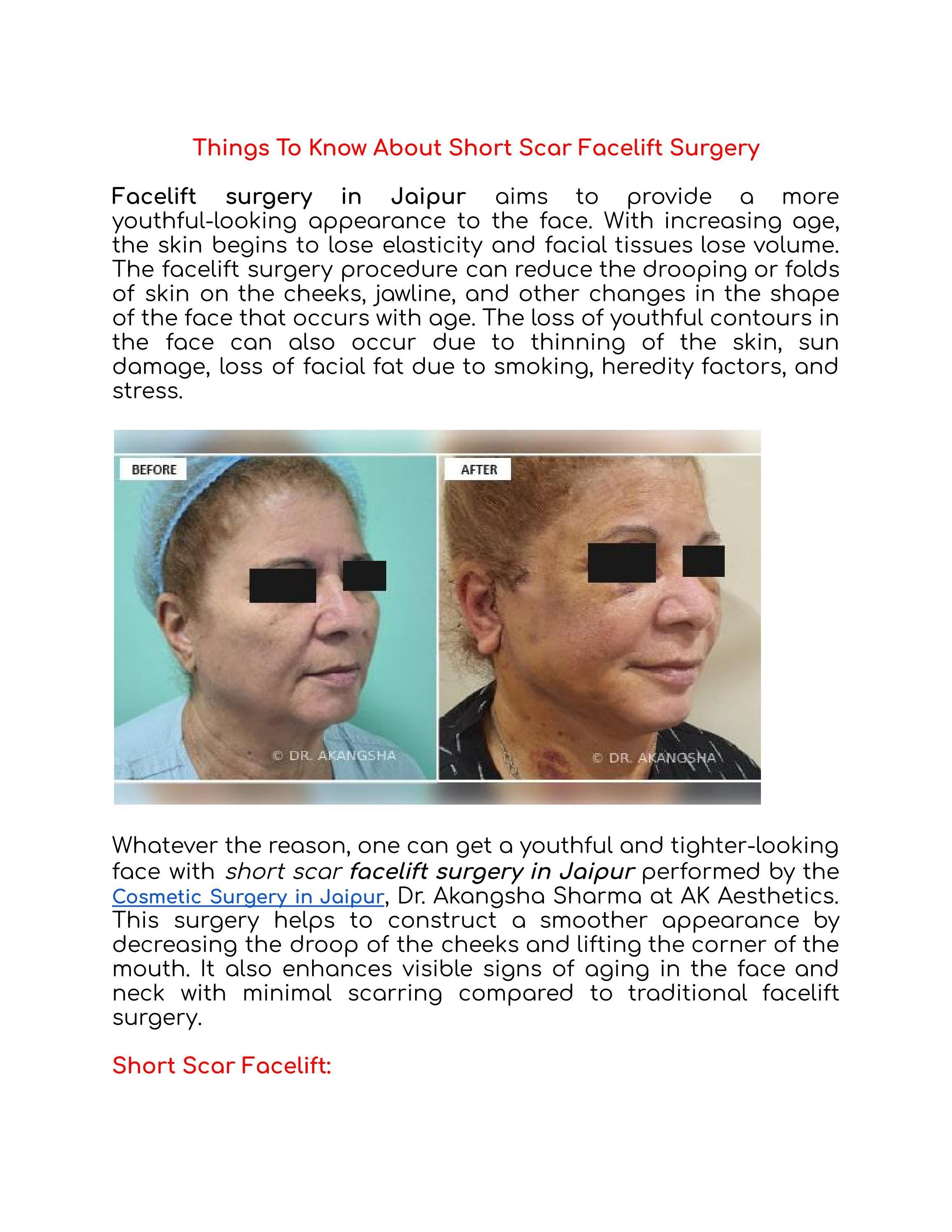 Things To Know About Short Scar Facelift Surgery by Anika Sharma - Issuu
