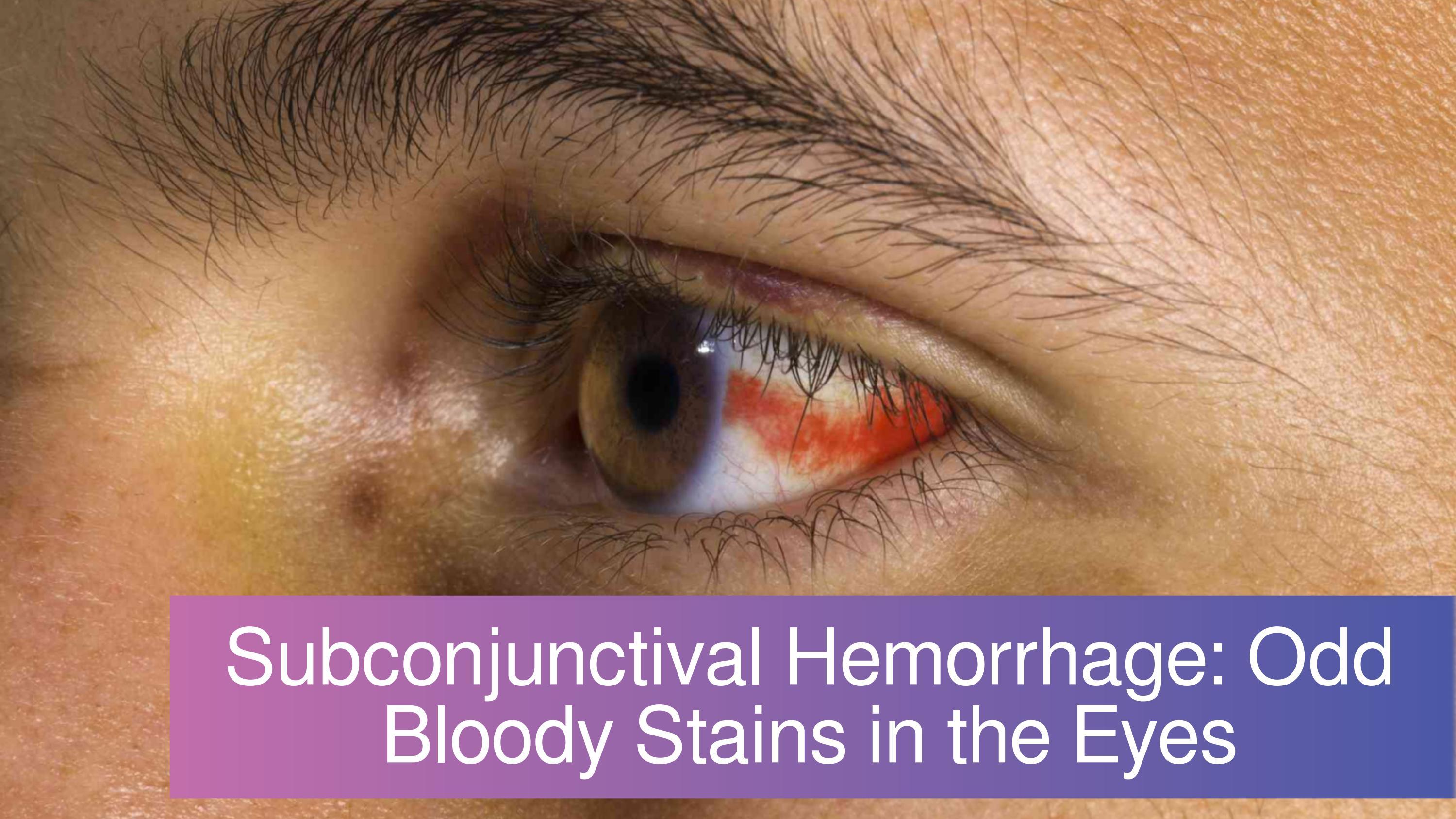 Subconjunctival Hemorrhage: Odd Bloody Stains in the Eyes by ...