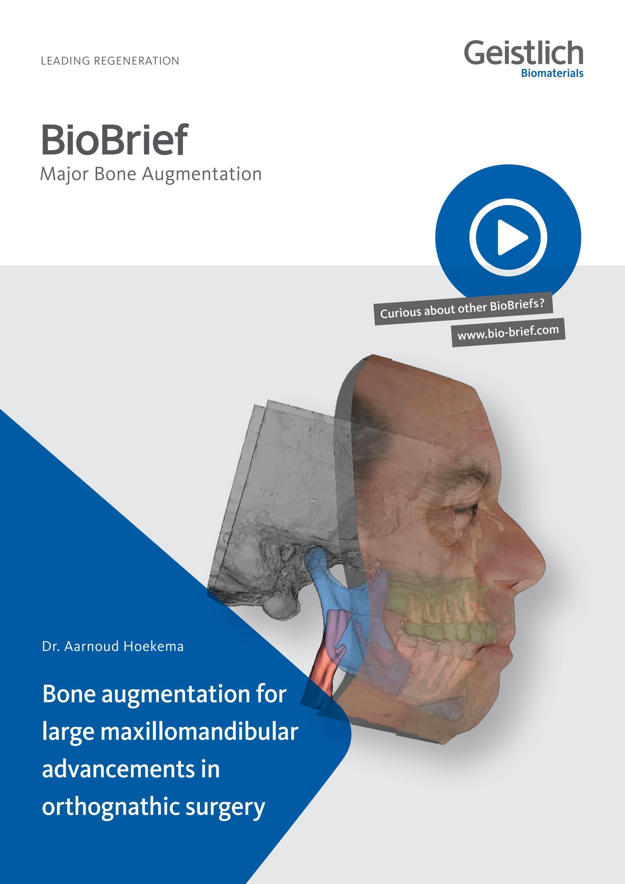 Bone augmentation for large maxillomandibular advancements in ...