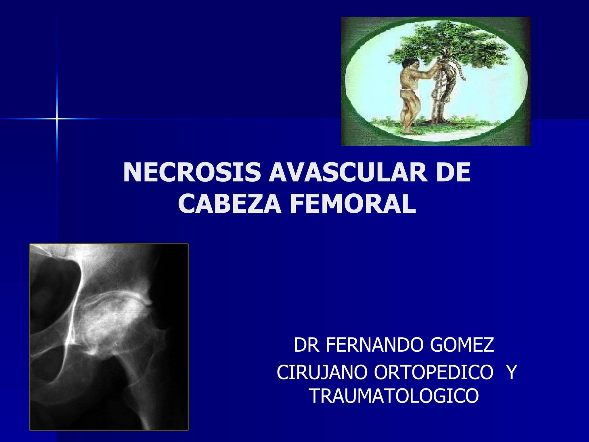 Necrosis avascular femoral by Ferluisgo1 - Issuu