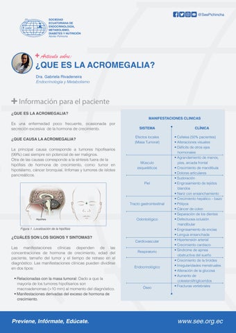 ¿Qué es la Acromegalia? by Sociedad Ecuatoriana de Endocrinología - Issuu
