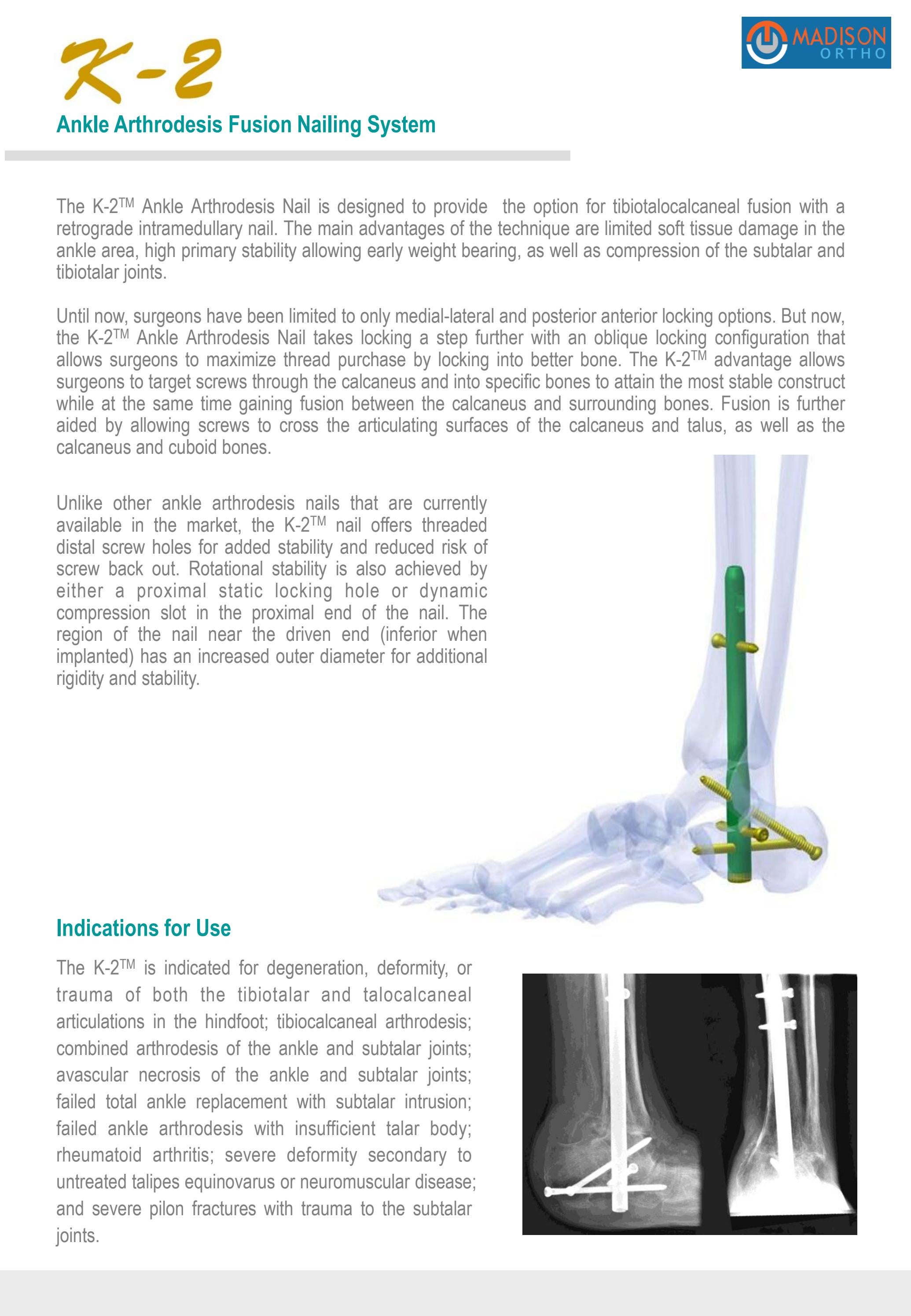 Ankle Arthrodesis Fusion Nailing System by andrewrodrigues110822 - Issuu