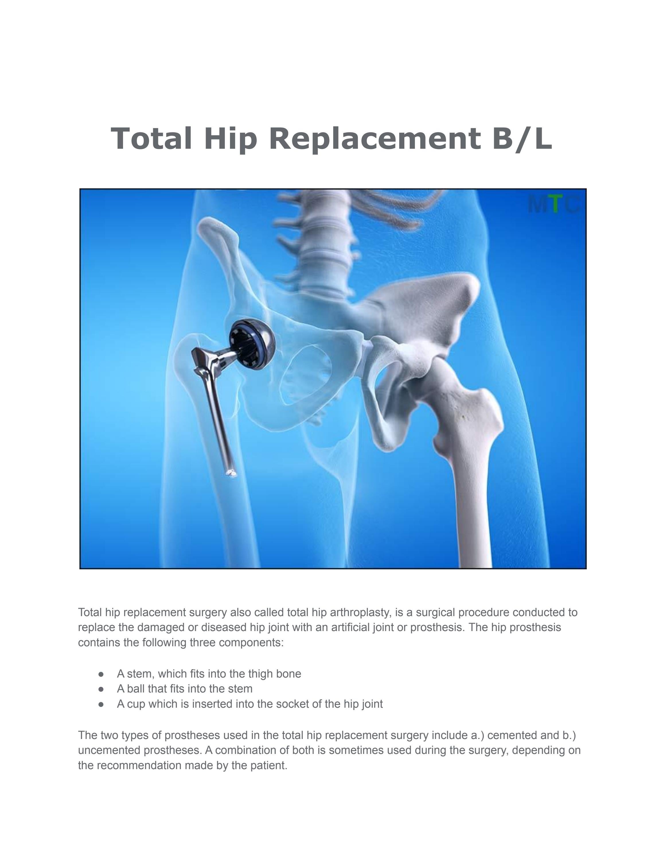 Total Hip Replacement B/L by drkumrvishal - Issuu