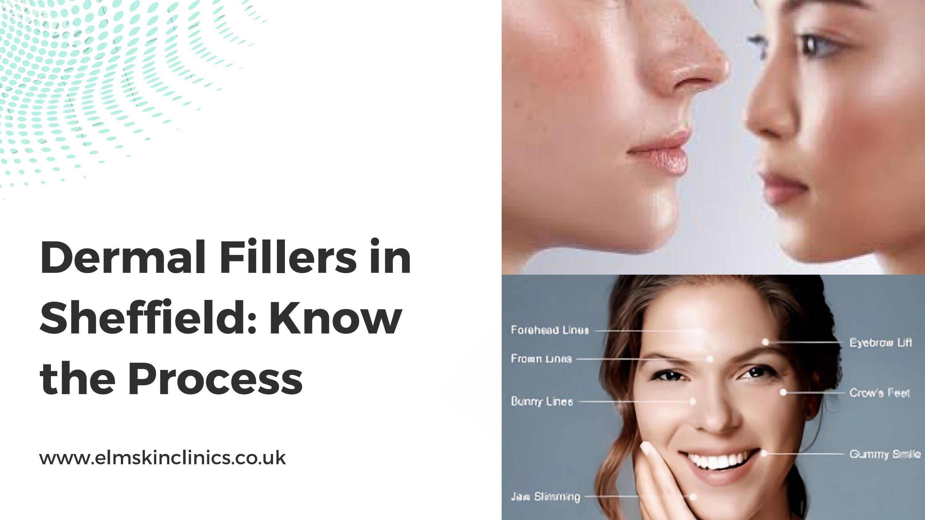 Dermal Fillers in Sheffield Know the Process by Elm Skin Clinics - Issuu