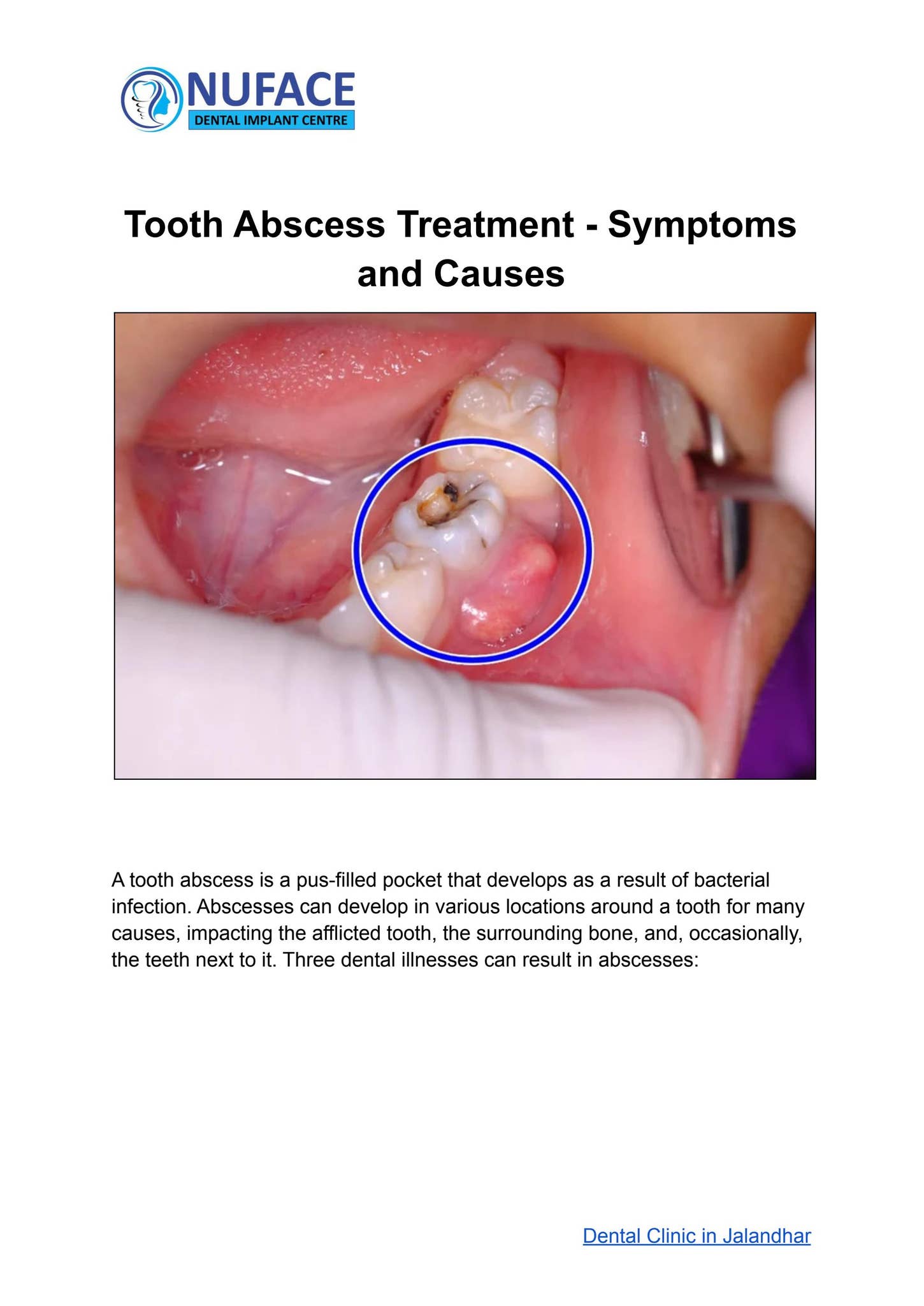 Periapical Abscess Treatment