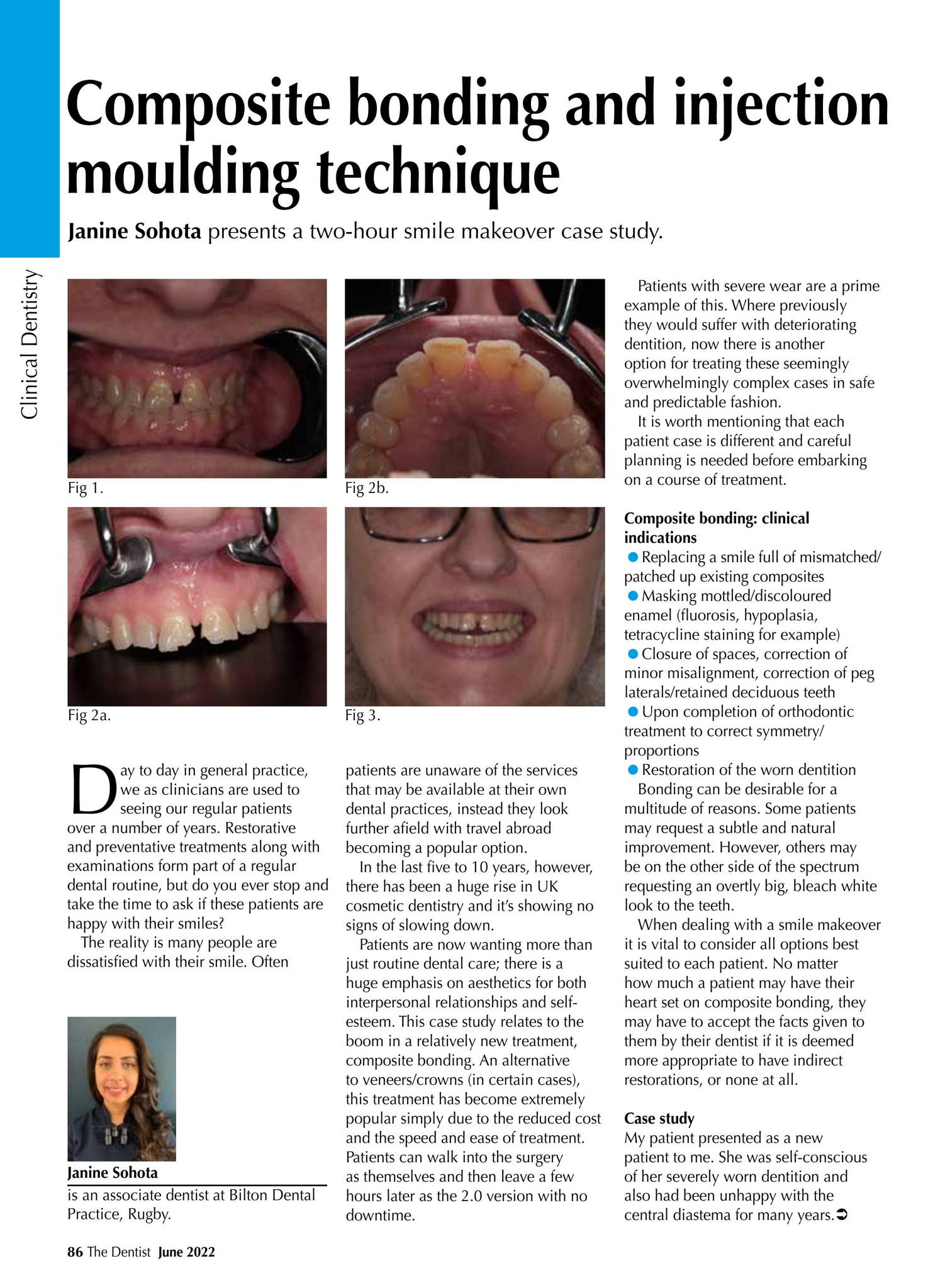 Composite bonding and injection moulding technique by HenryScheinUK - Issuu