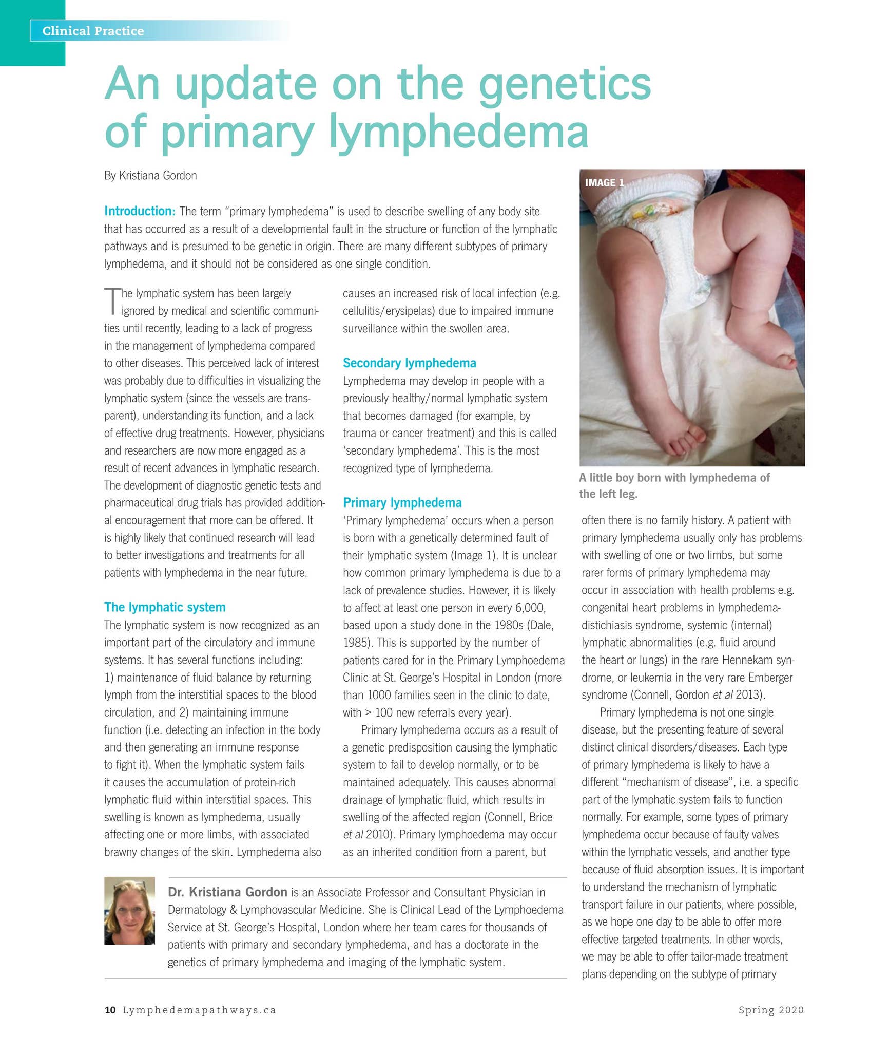 An update on the genetics of primary lymphedema. K. Gordon. by Canadian Lymphedema Framework - Issuu