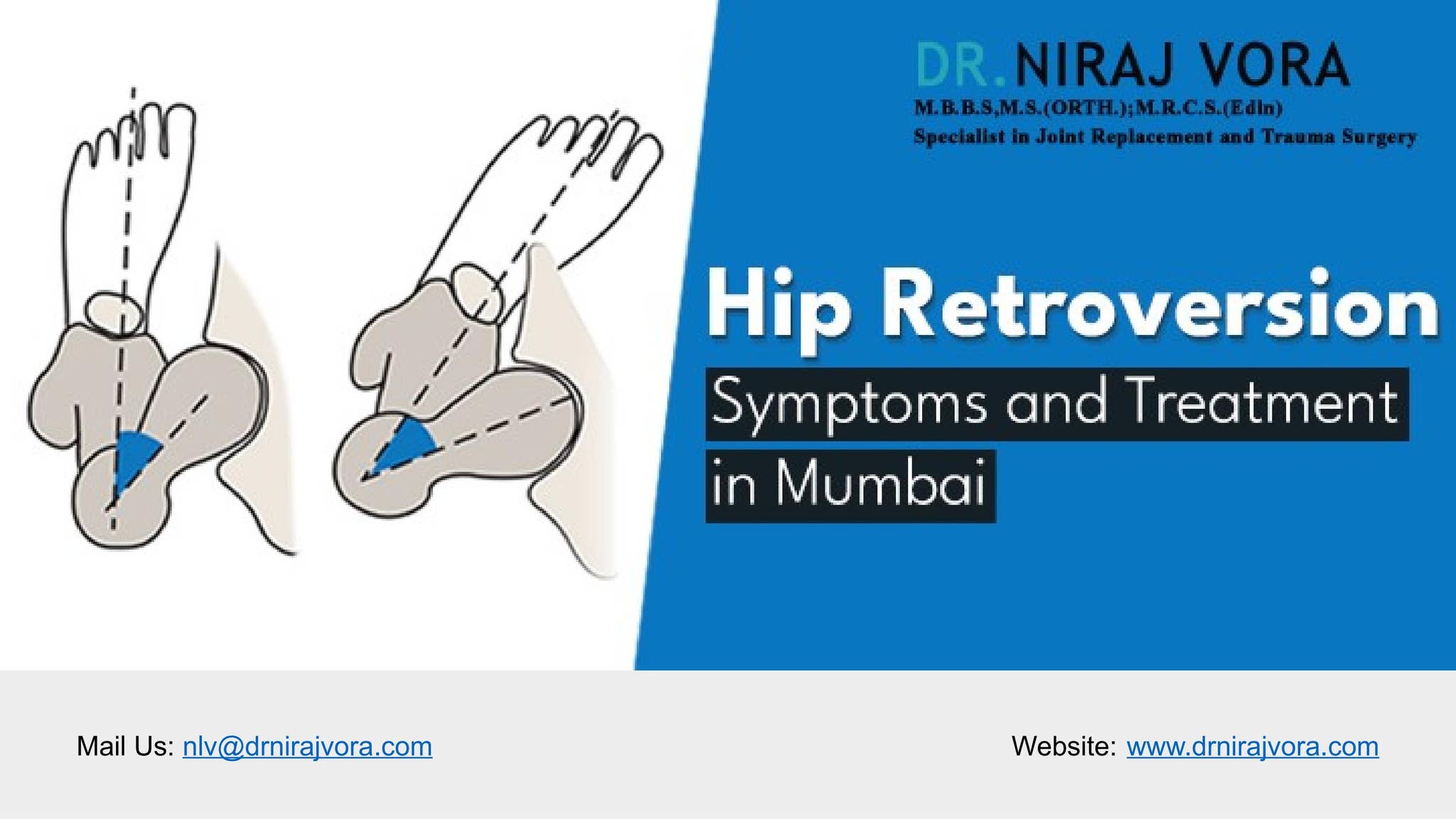 Hip Retroversion Symptoms and Treatment in Mumbai | Dr Niraj Vora by ...