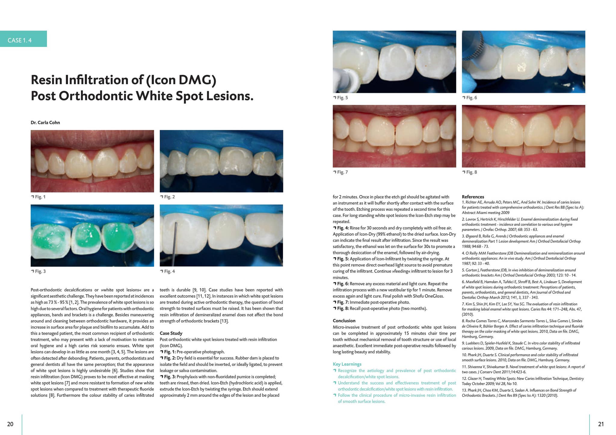 Resin Infiltration of (Icon DMG) Post Orthodontic White Spot Lesions by ...