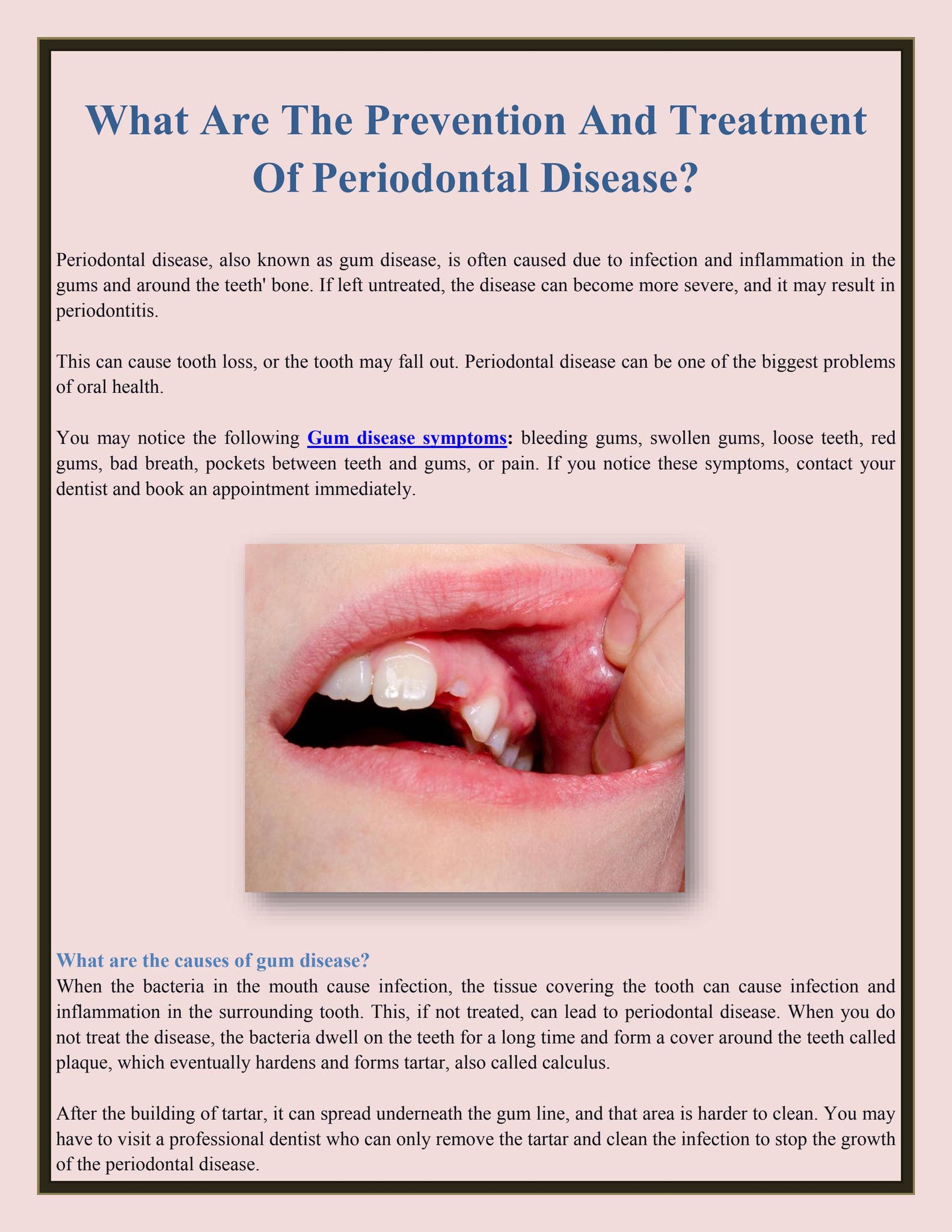 What Are The Prevention And Treatment Of Periodontal Disease? by ...