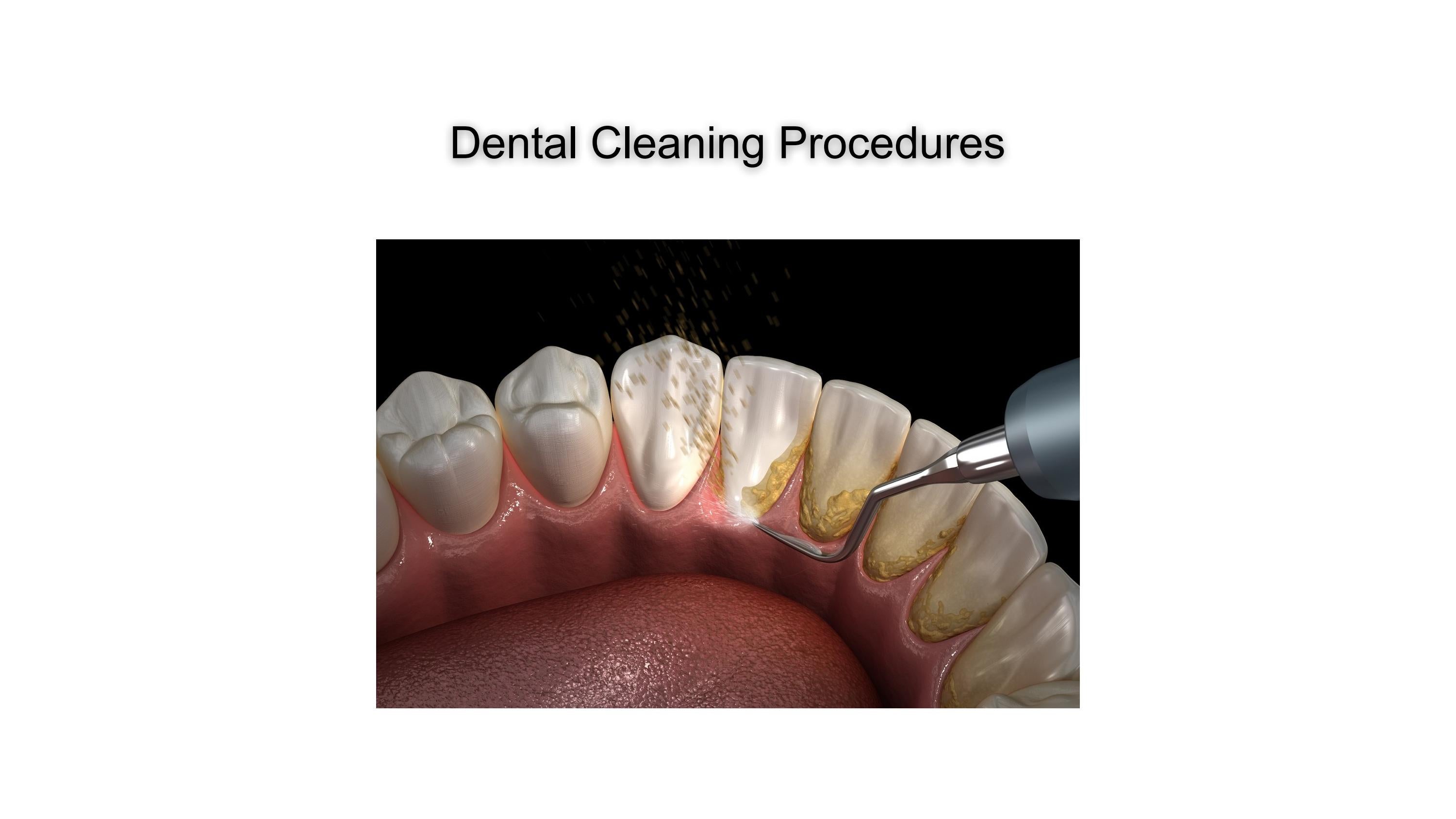 The Importance of Dental Cleaning: Procedures and Techniques by Nuface ...