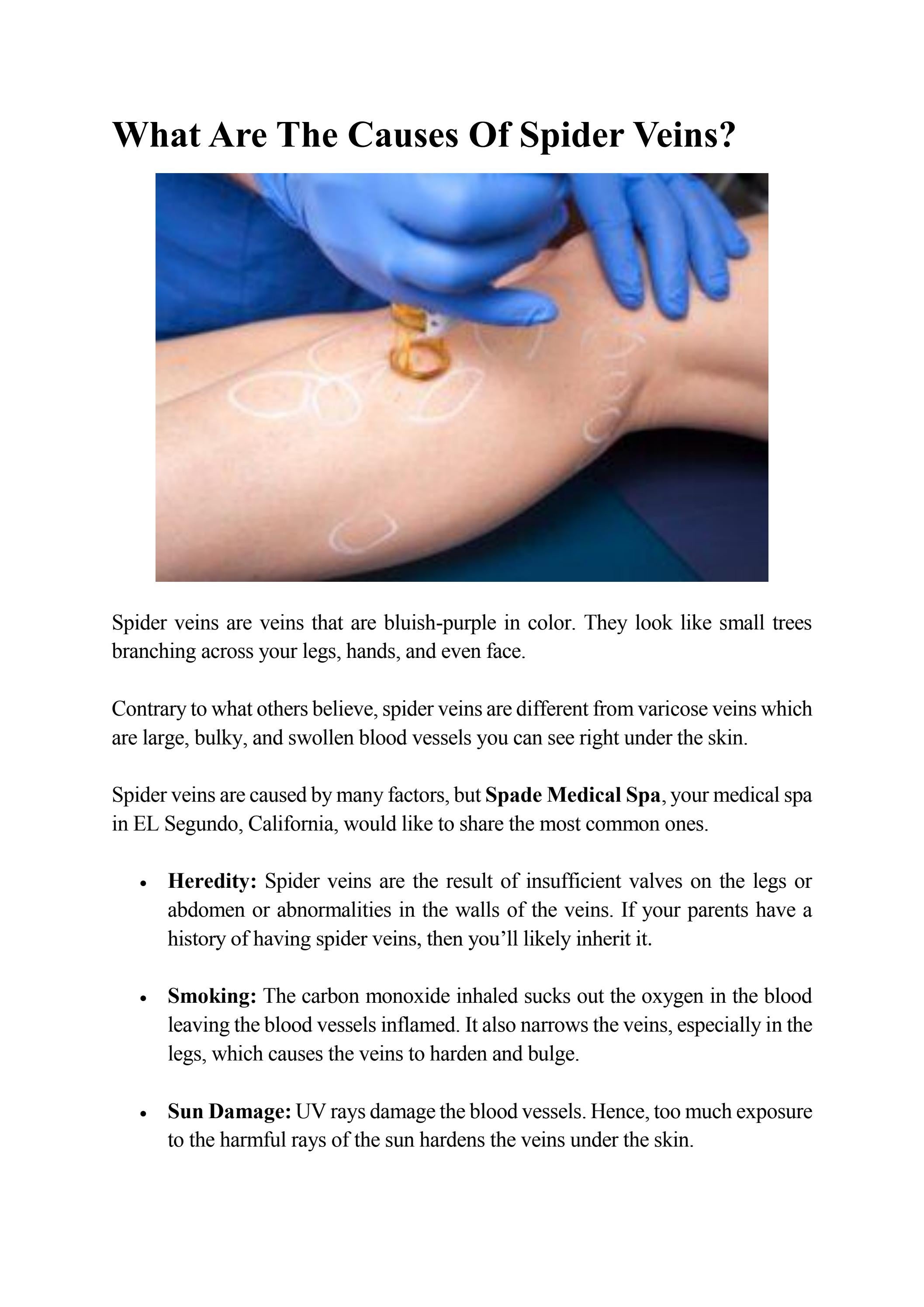What Are The Causes Of Spider Veins By John Simmond Issuu
