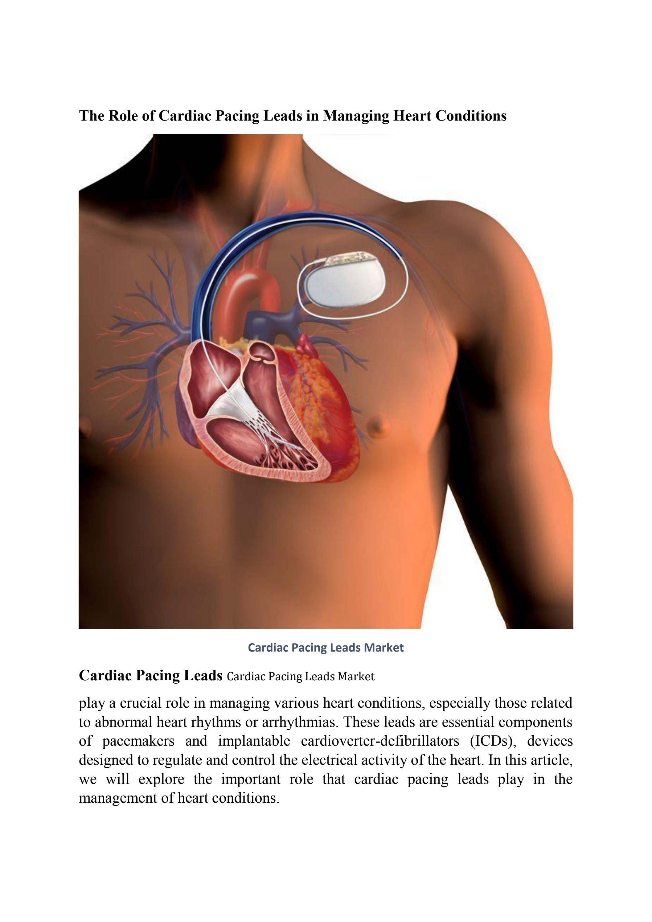 The Role of Cardiac Pacing Leads in Managing Heart Conditions by Poonam Cmi - Issuu