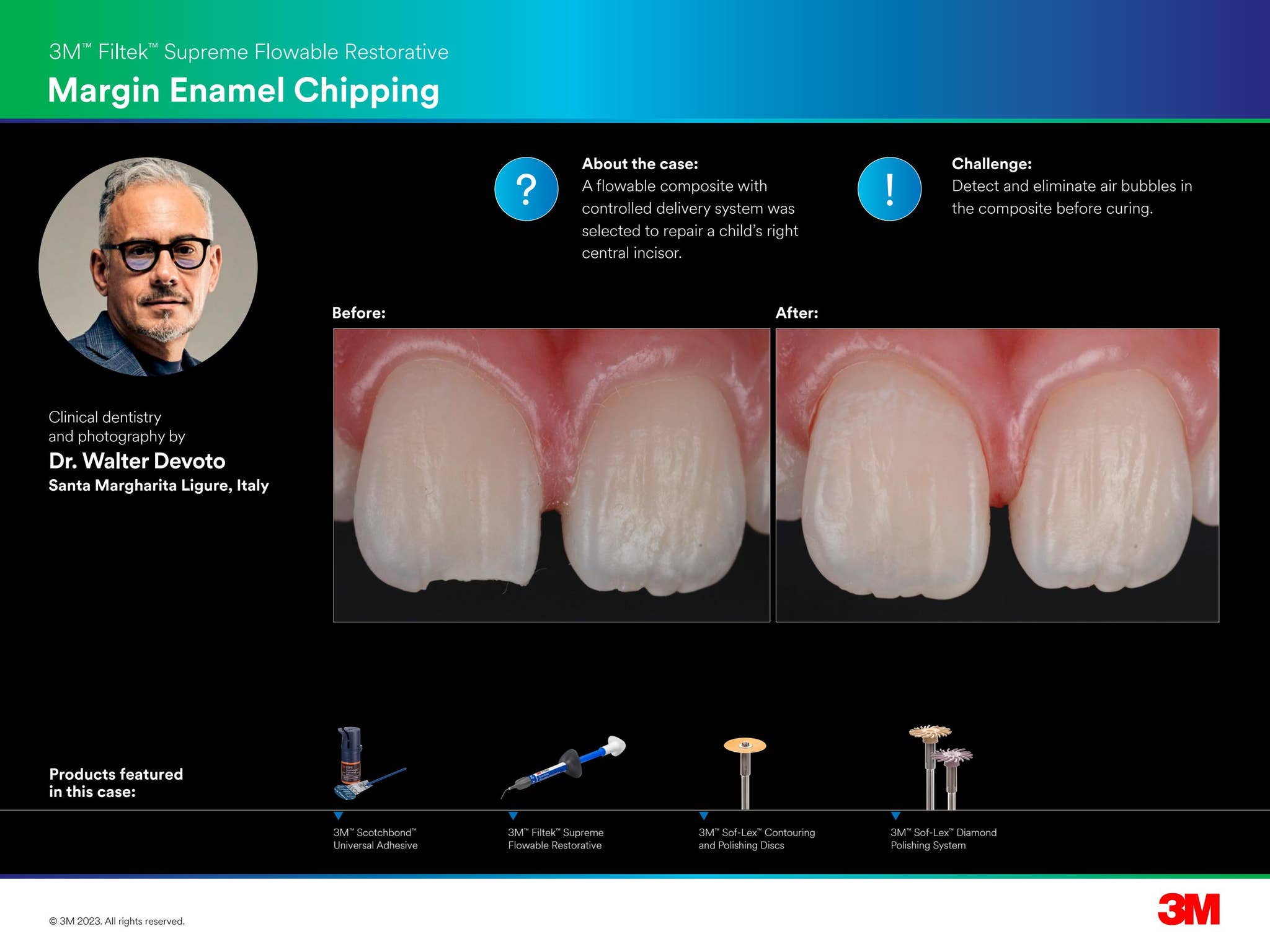 Margin Enamel Chipping by Jacobsen Dental AS - Issuu