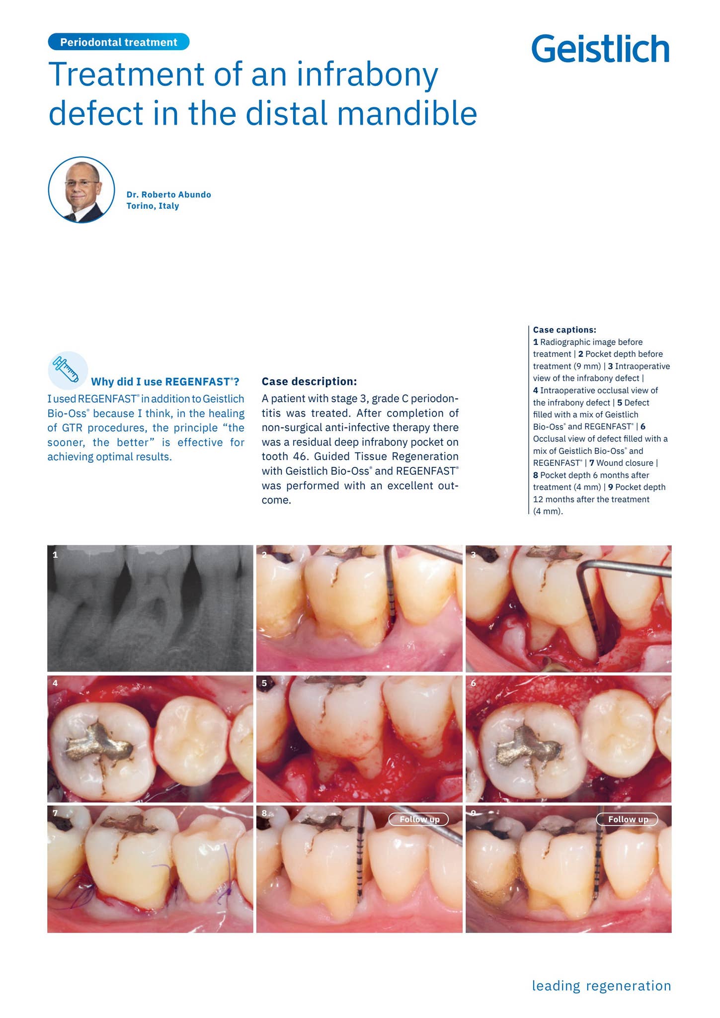 Treatment of an infrabony defect in the distal mandible by Geistlich ...