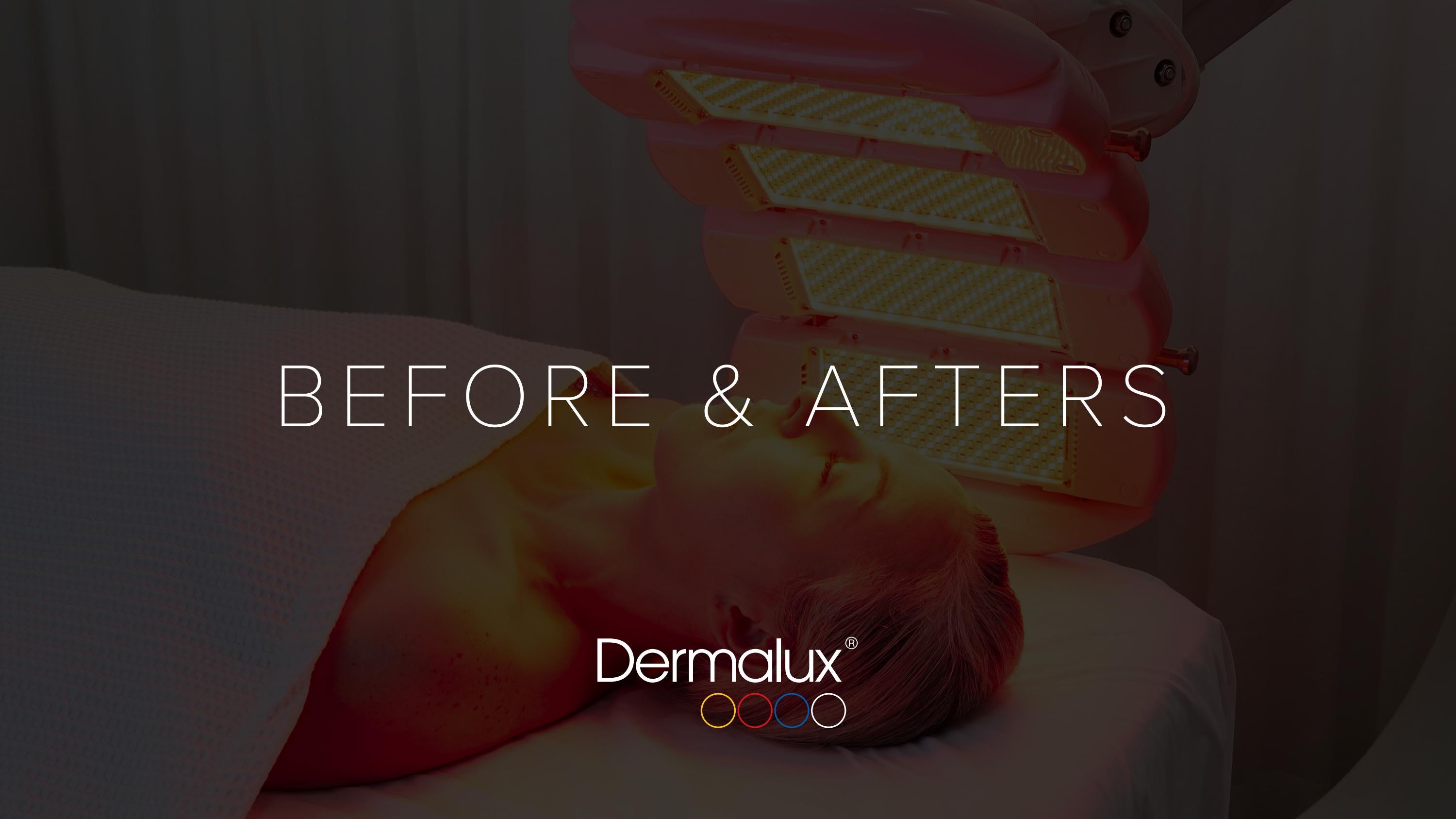 DERMALUX Before & After Presentation by Professional Beauty Solutions ...